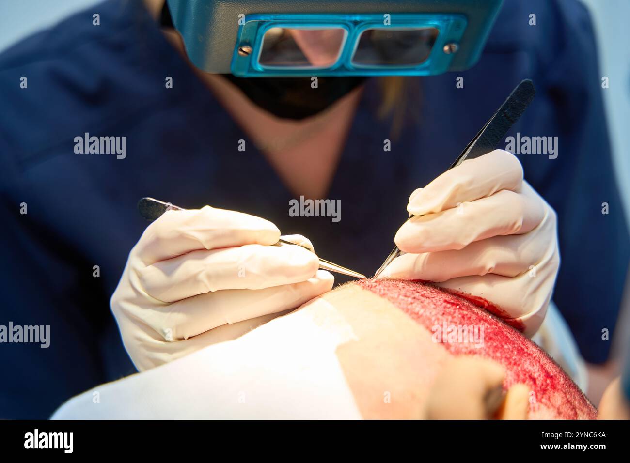 Surgeon performing hair transplant surgery with precision tools Stock ...