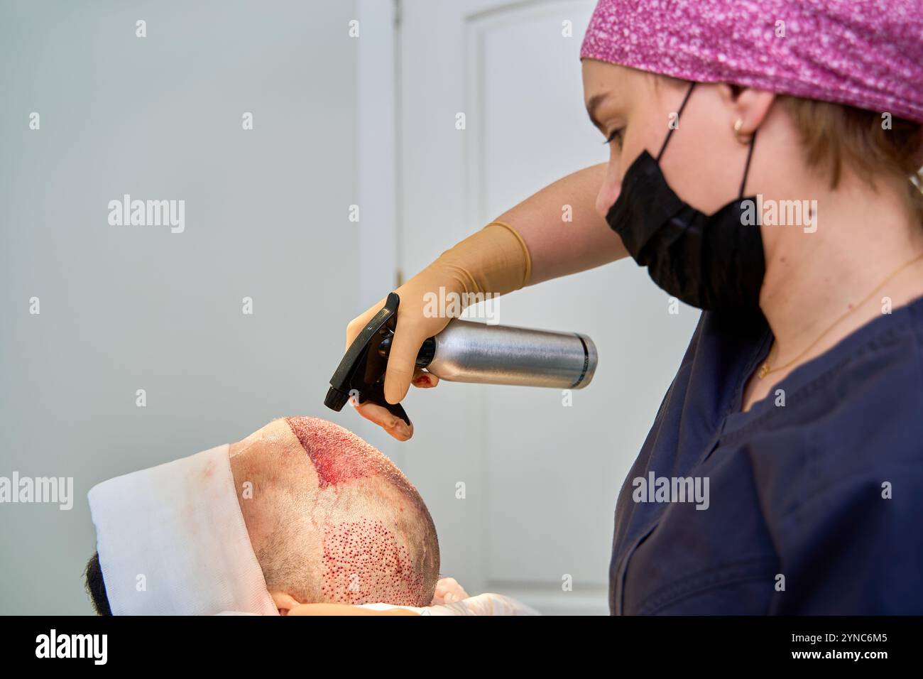 Hair transplant procedure with technician spraying scalp post-operation ...