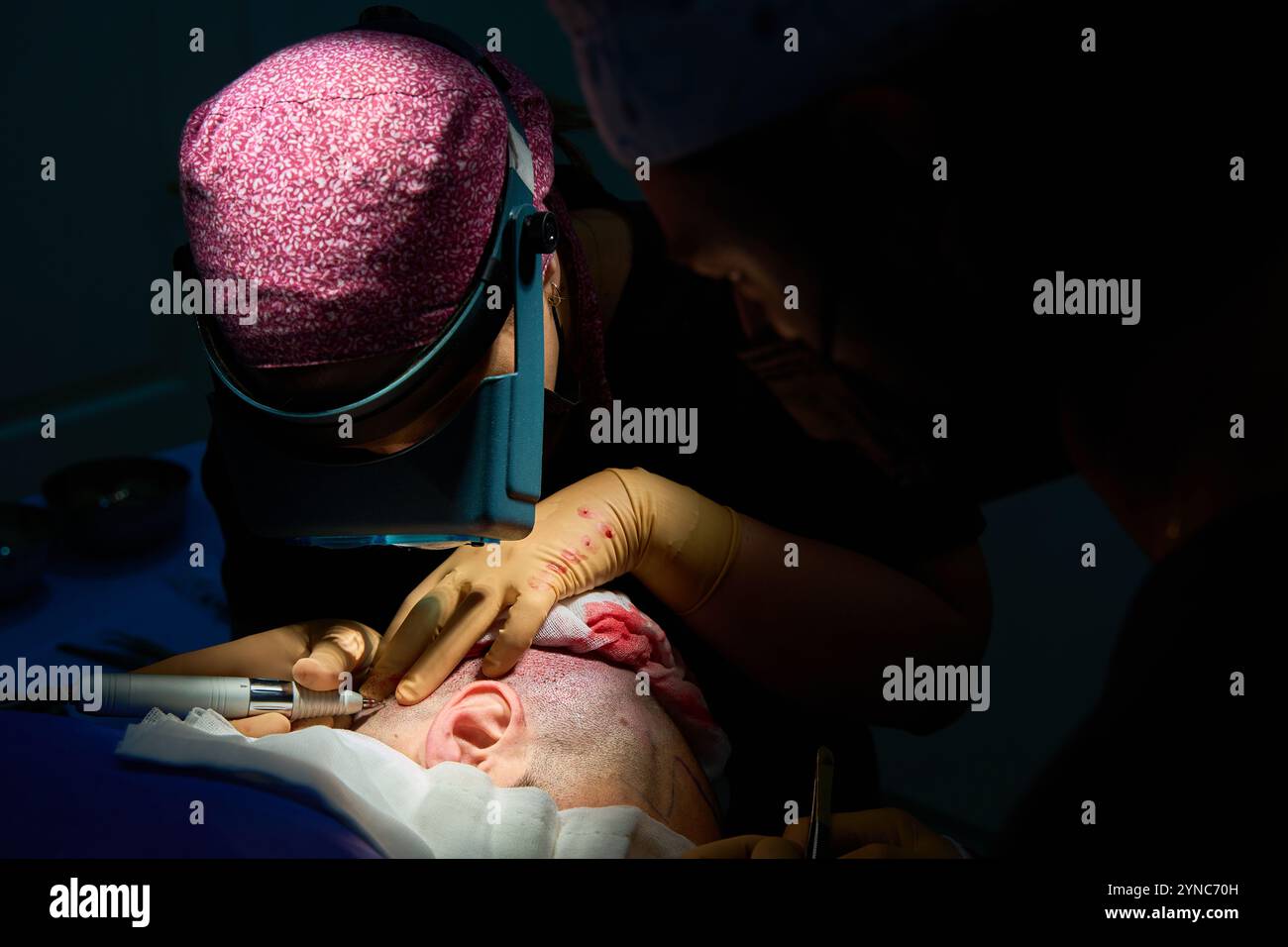 Surgeons carefully performing a hair transplant procedure on a patient ...