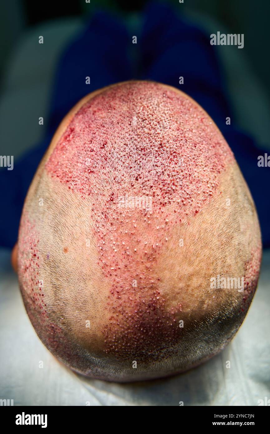 Close-up of scalp after hair transplant surgery with implanted ...