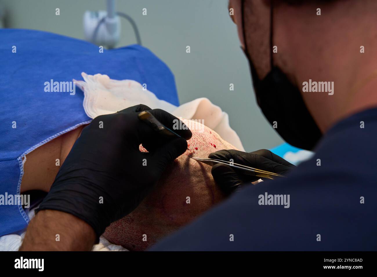 hair, transplant, surgeon, precision ,tools, scalp, surgery, medical ...