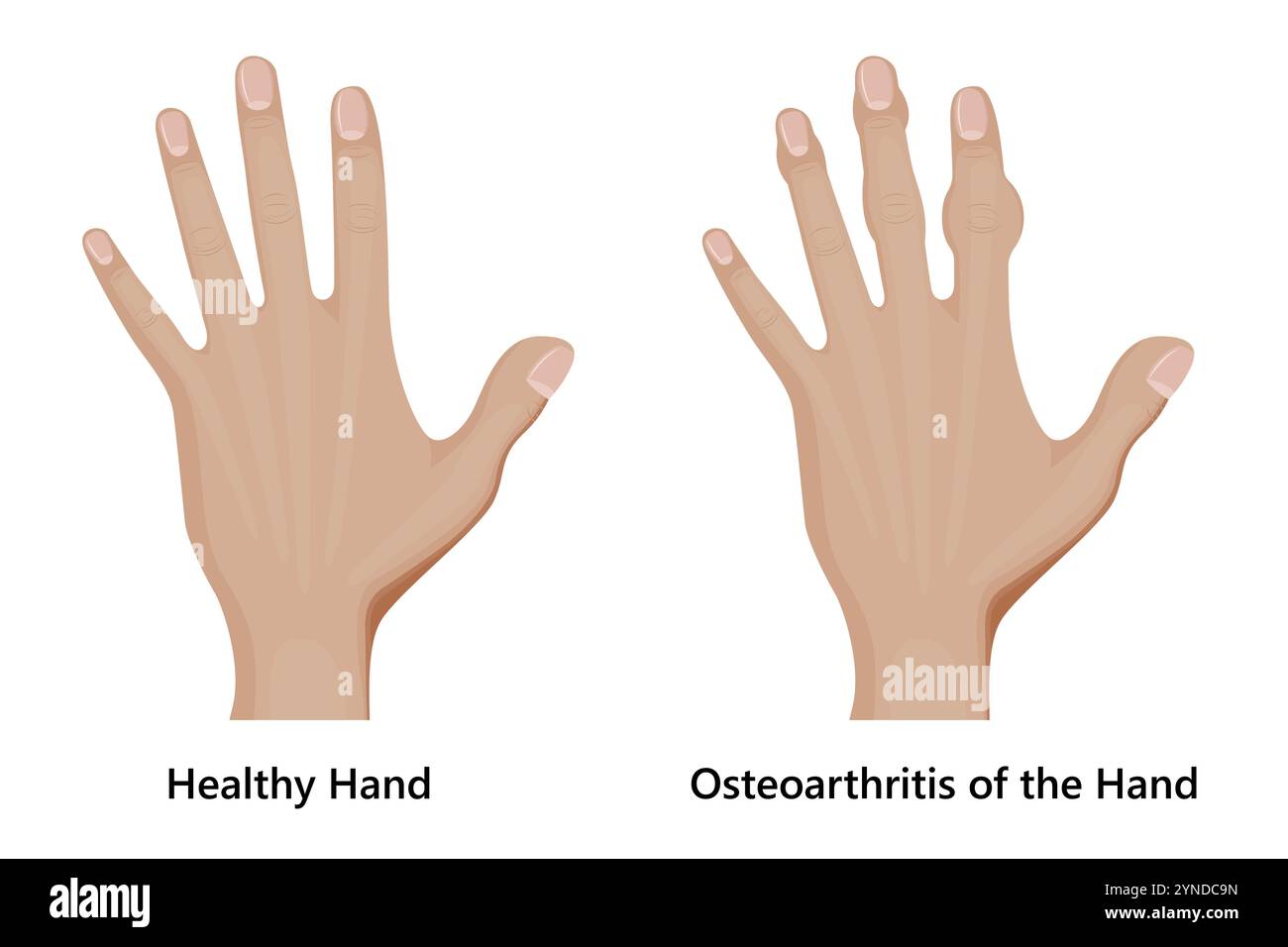 Healthy Hand and Hand with Osteoarthritis Stock Vector Image & Art - Alamy