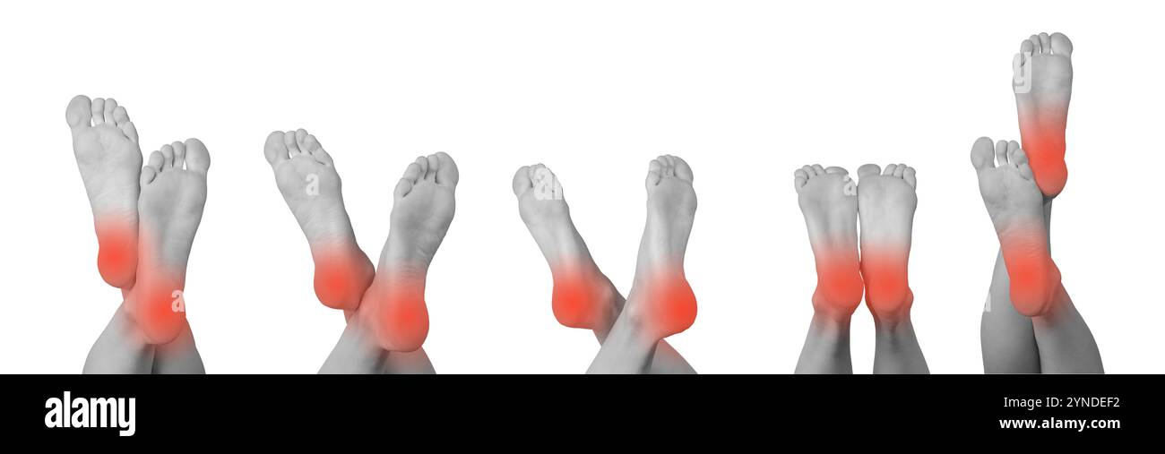 Set of female feet showing symptoms of pain and injury, including heel ...