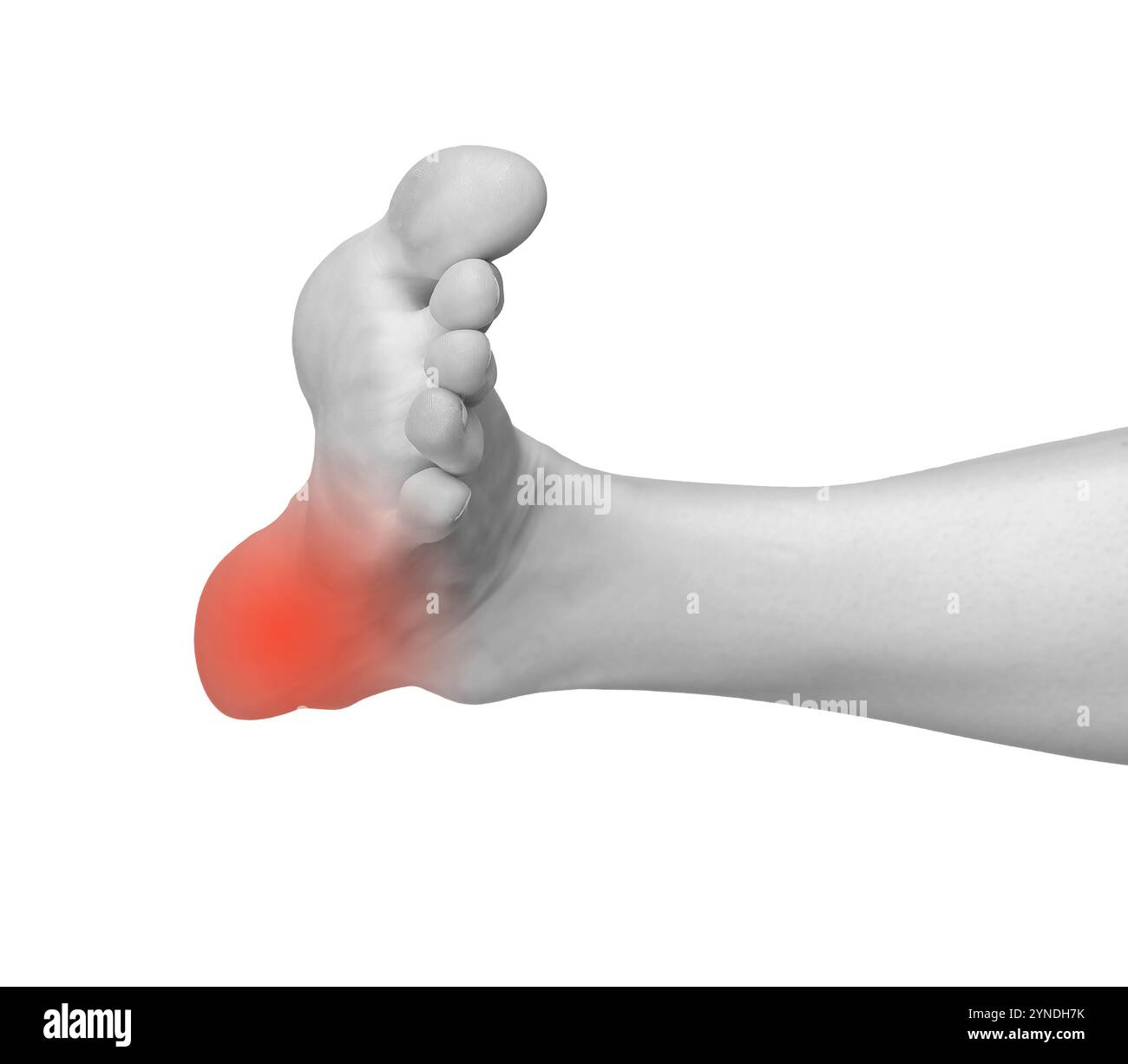 Heel pain, inflamed foot joint with soreness and injury. Chronic ...
