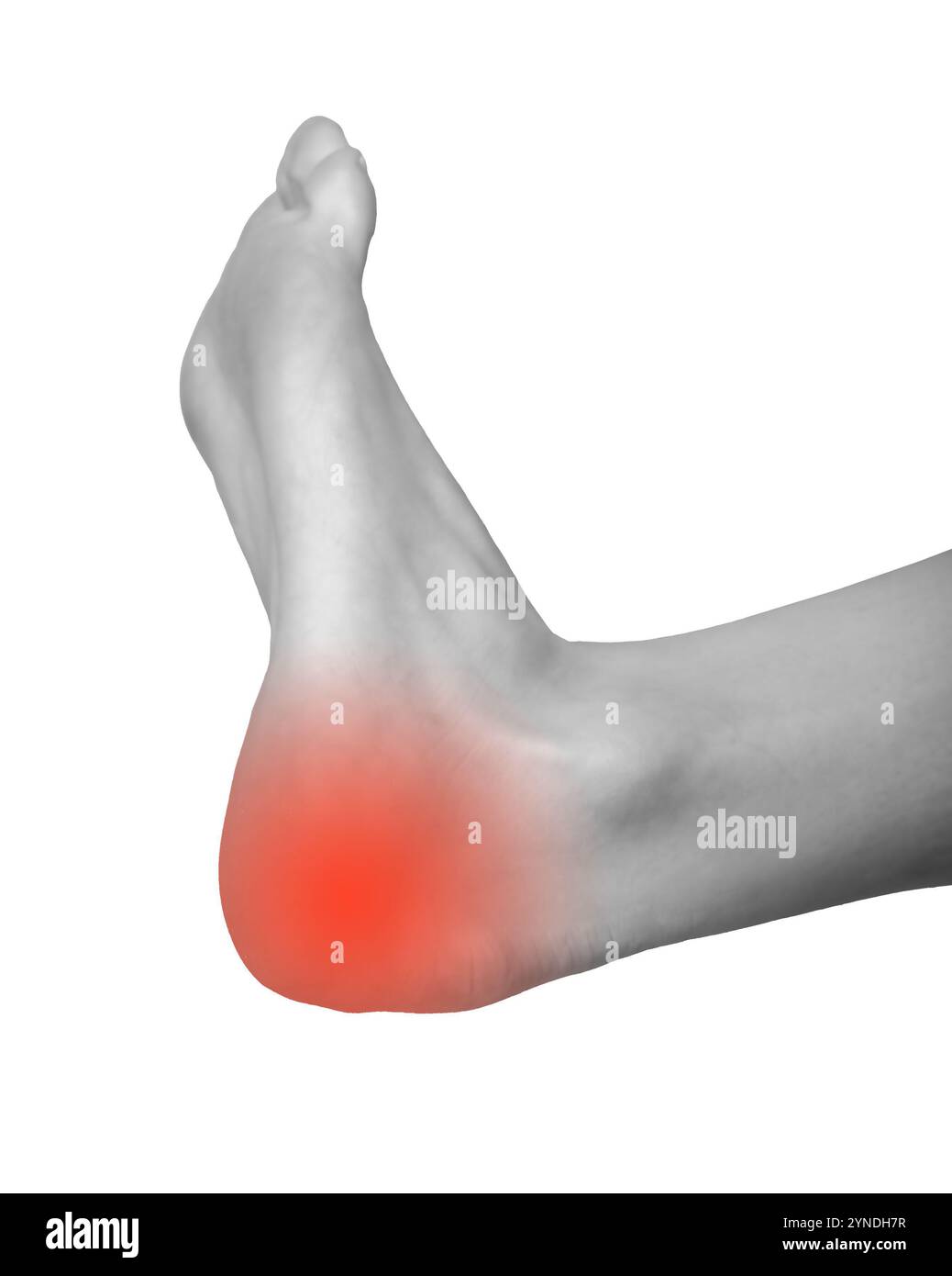 Heel pain, foot joint ache, and inflammation due to arthritis and gout ...