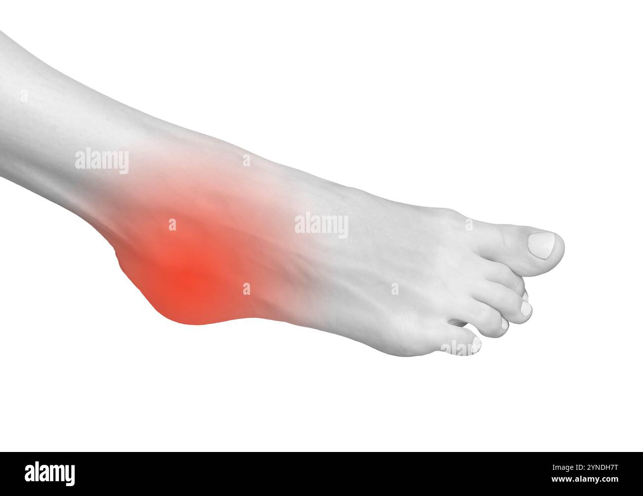 Heel pain and joint ache with neuropathy symptoms. Tensed feet with ...