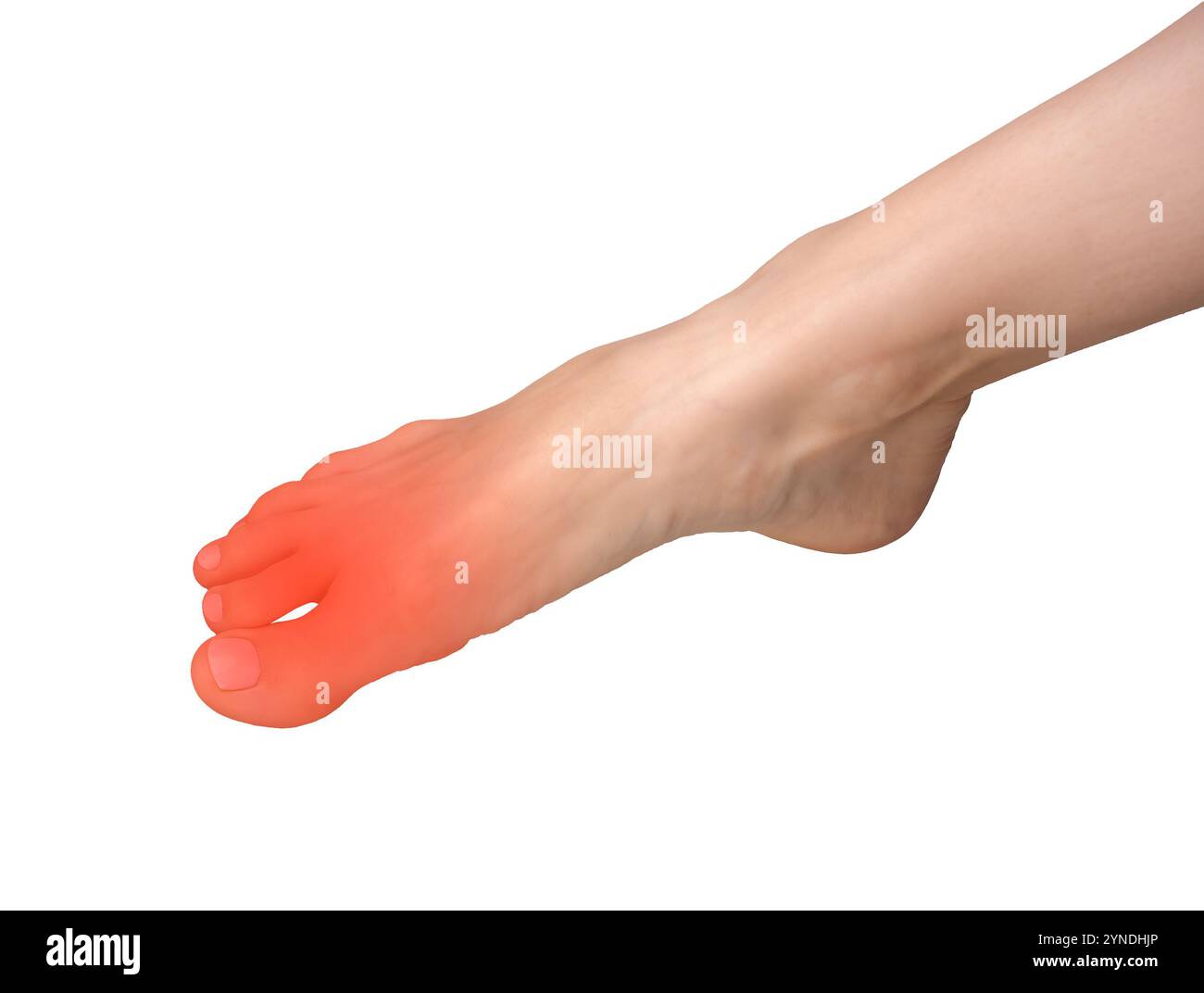 Foot pain with inflamed joint and neuropathy. Big toe ache, cramp, or ...