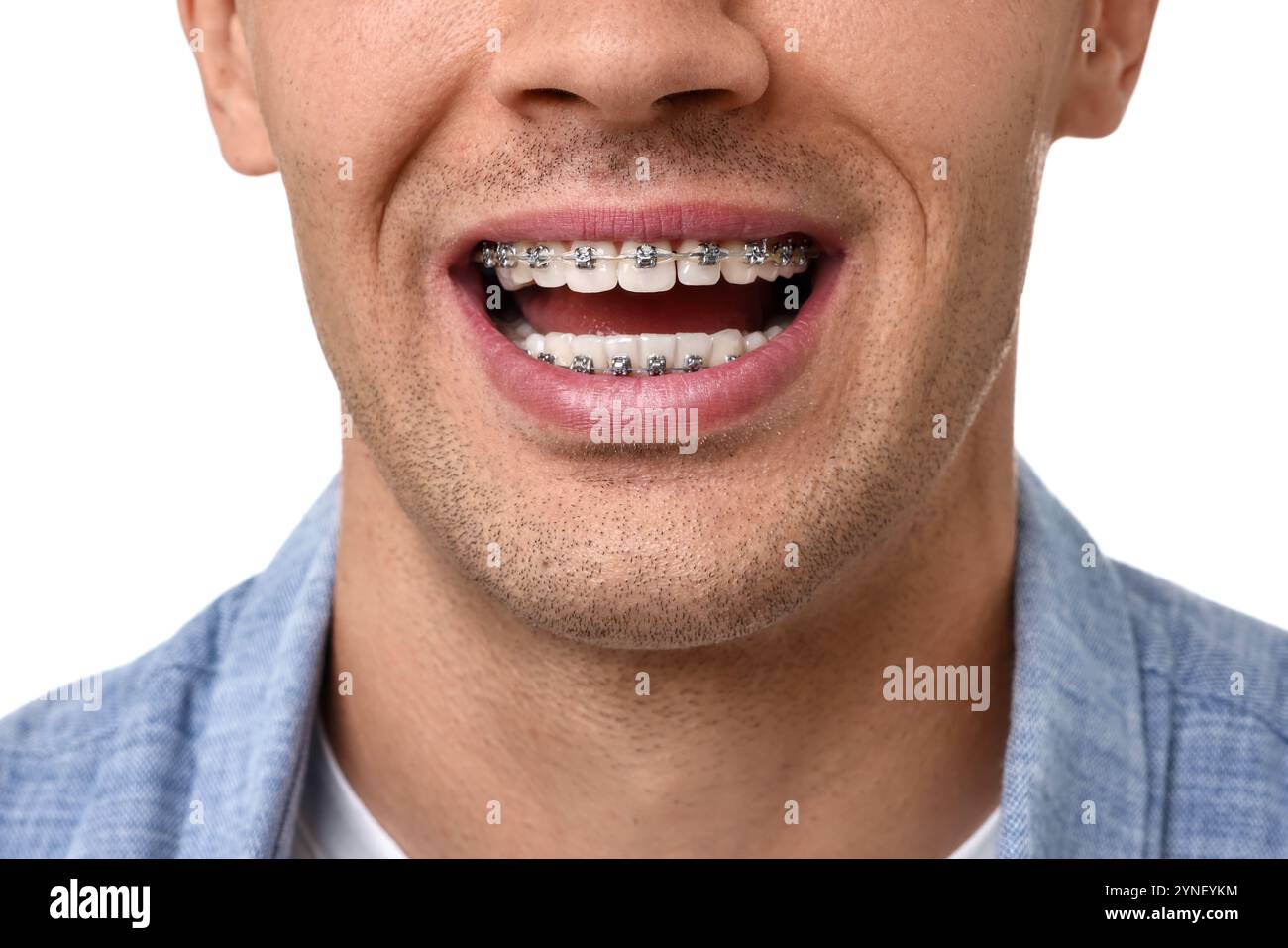Happy man with dental braces on white background, closeup Stock Photo ...