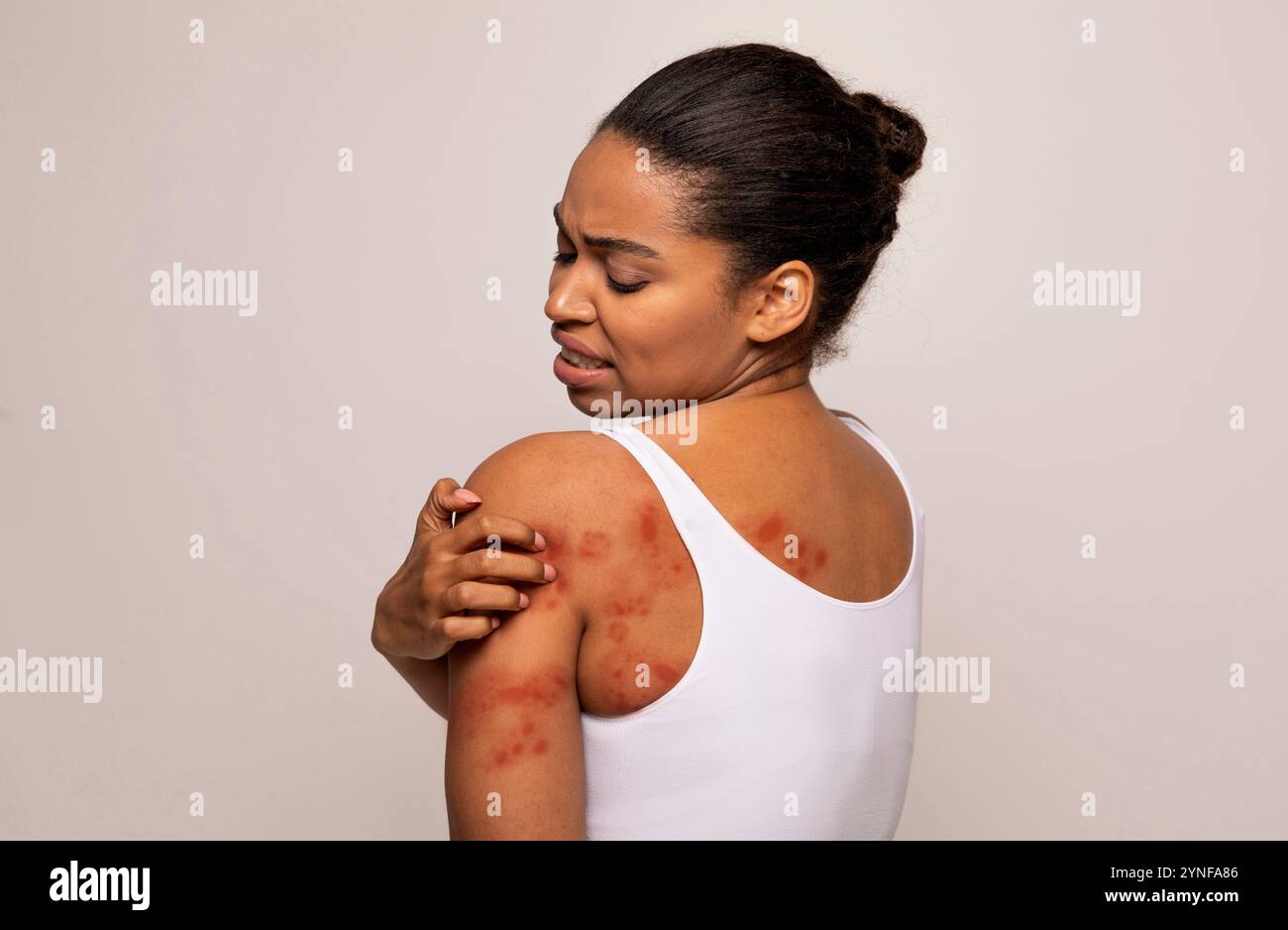 Black woman scratching red spots on her skin Stock Photo - Alamy