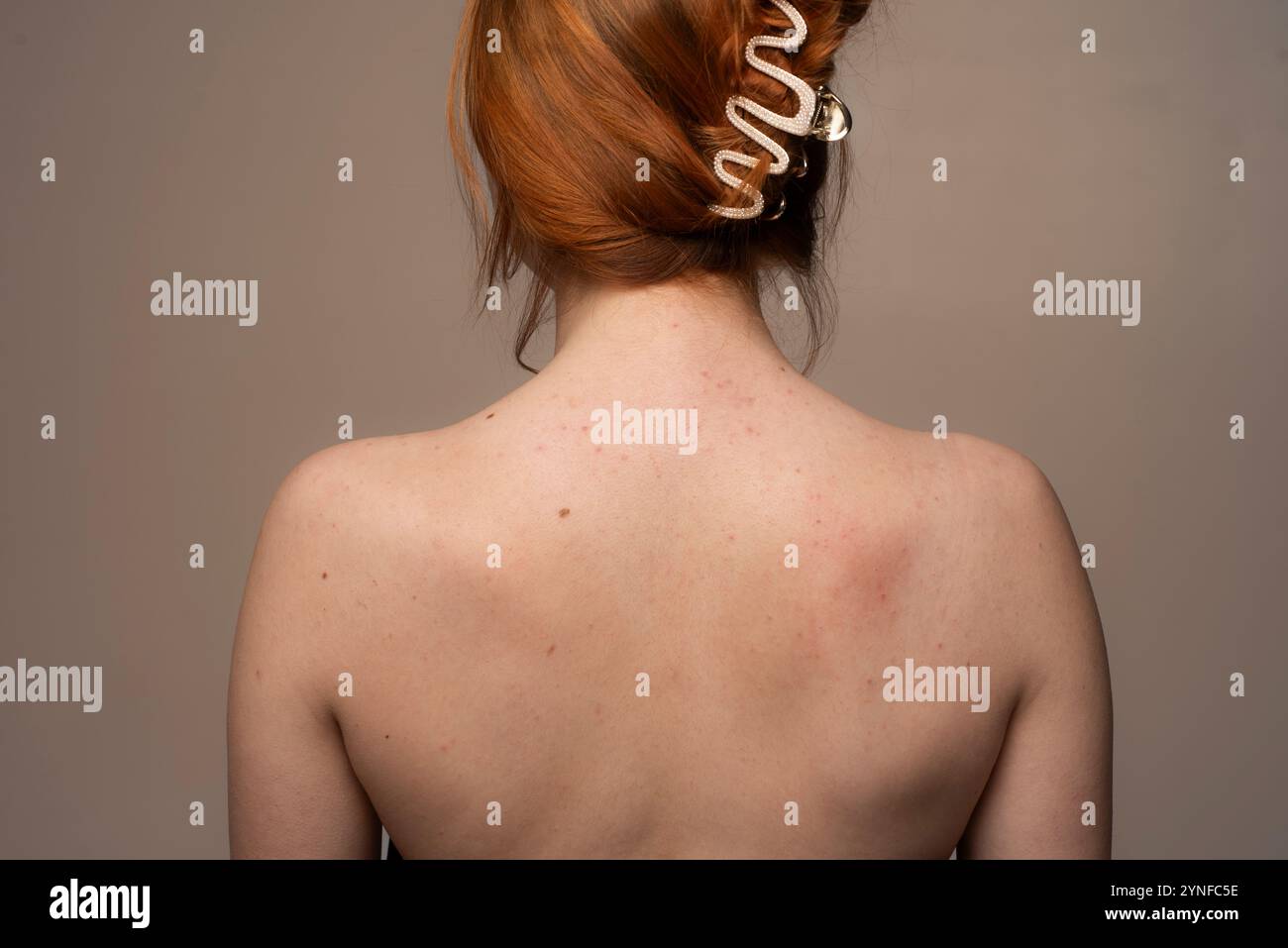 Acne skin. Skin acne background. Acne problem on back. Dermatology and ...