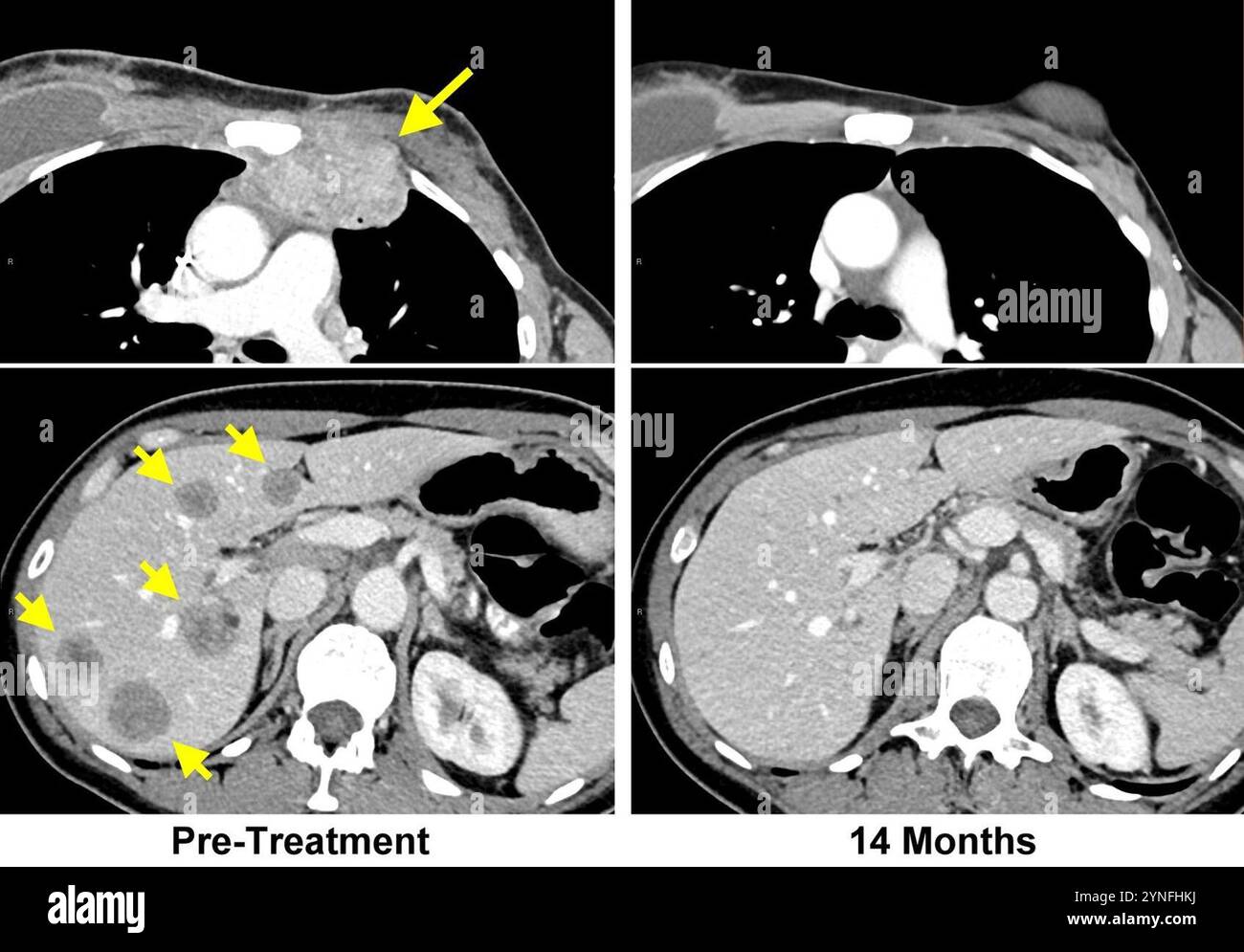 Cancer MRI Scans (28750336678 Stock Photo - Alamy