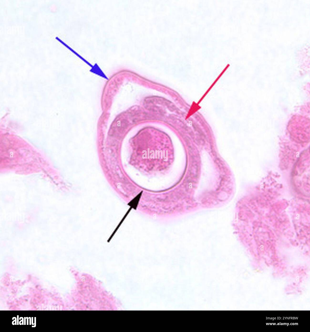 Capillaria philippinensis tissue 4 Stock Photo - Alamy