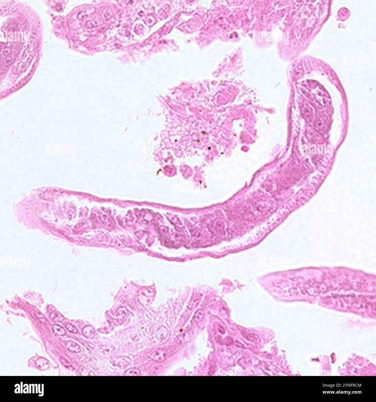 Capillaria philippinensis tissue6 Stock Photo - Alamy