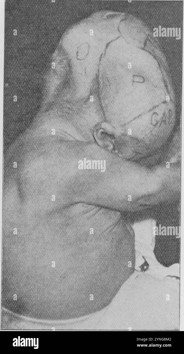 Carpenter syndrome hi-res stock photography and images - Alamy