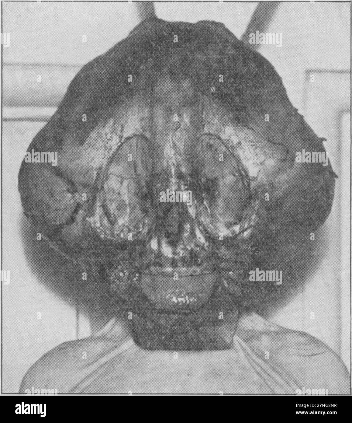 Carpenter syndrome hi-res stock photography and images - Alamy