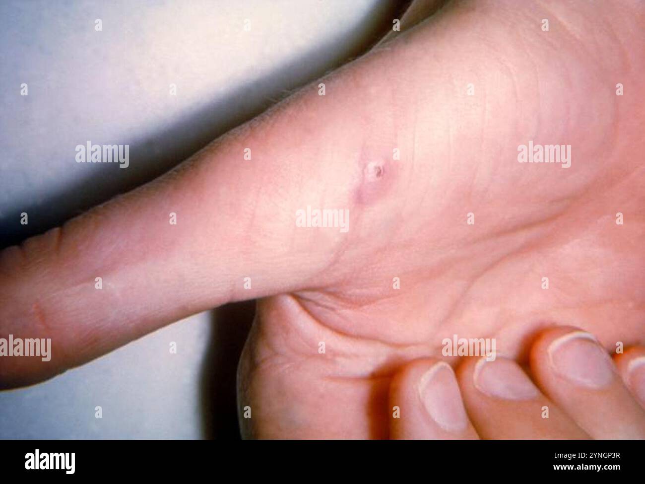 Cat-scratch disease lesion Stock Photo - Alamy