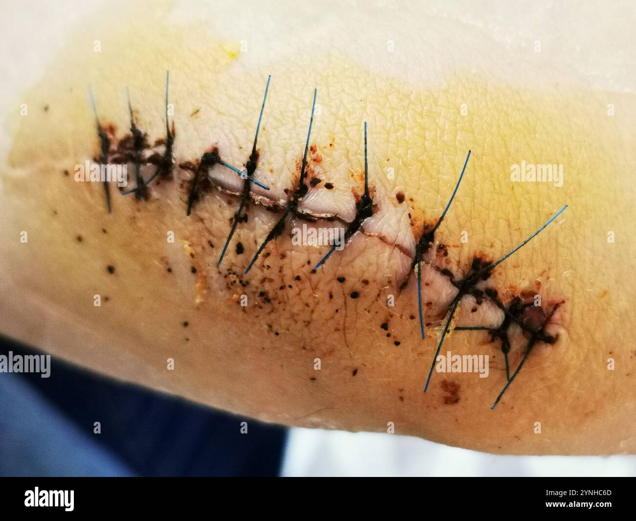 fresh human scar as real medicine background Stock Photo - Alamy