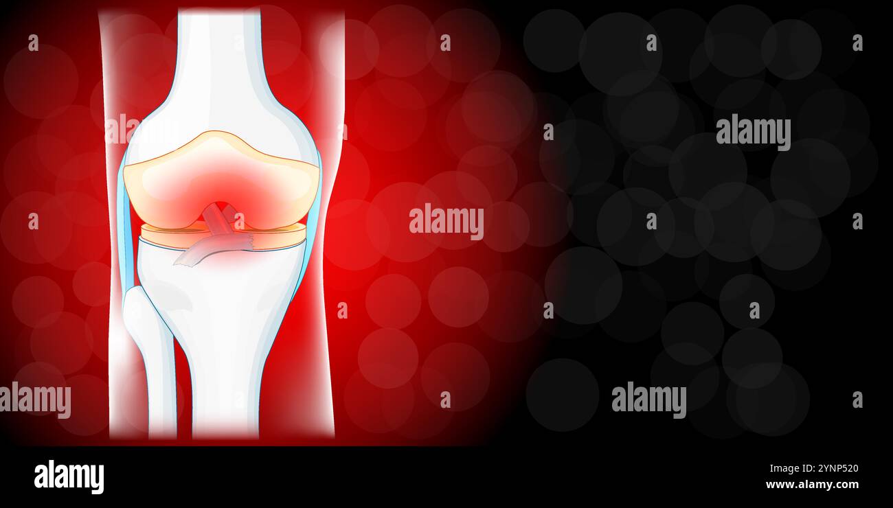 Knee joint pain. Front view of human knee. joint Inflammatory disease ...