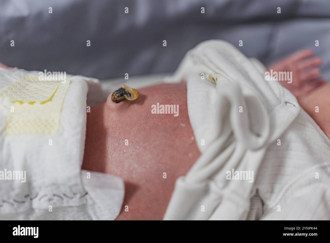 Close up on umbilical cord of newborn. Baby reddened skin Stock Photo ...