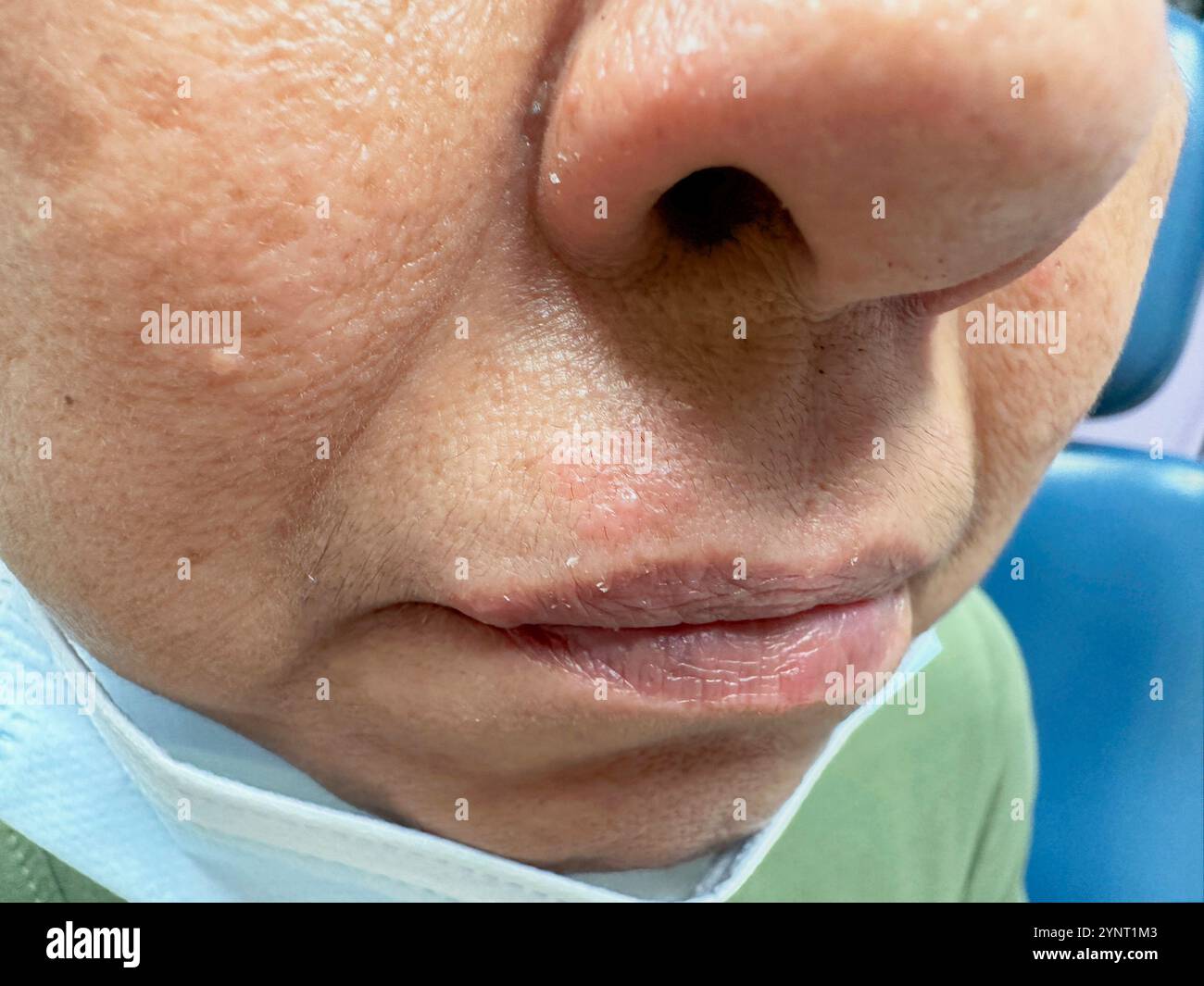 Editorial use only Blistering caused by herpes simplex virus (HSV ...