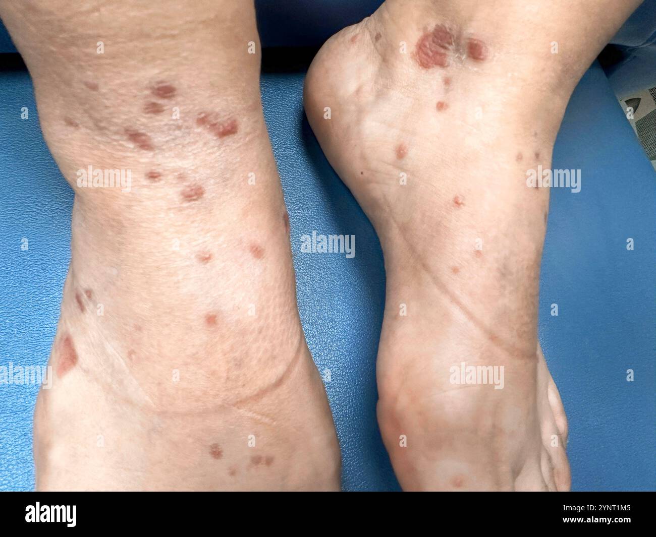 Lichen planus on a patient's ankles and feet. Lichen planus is an ...