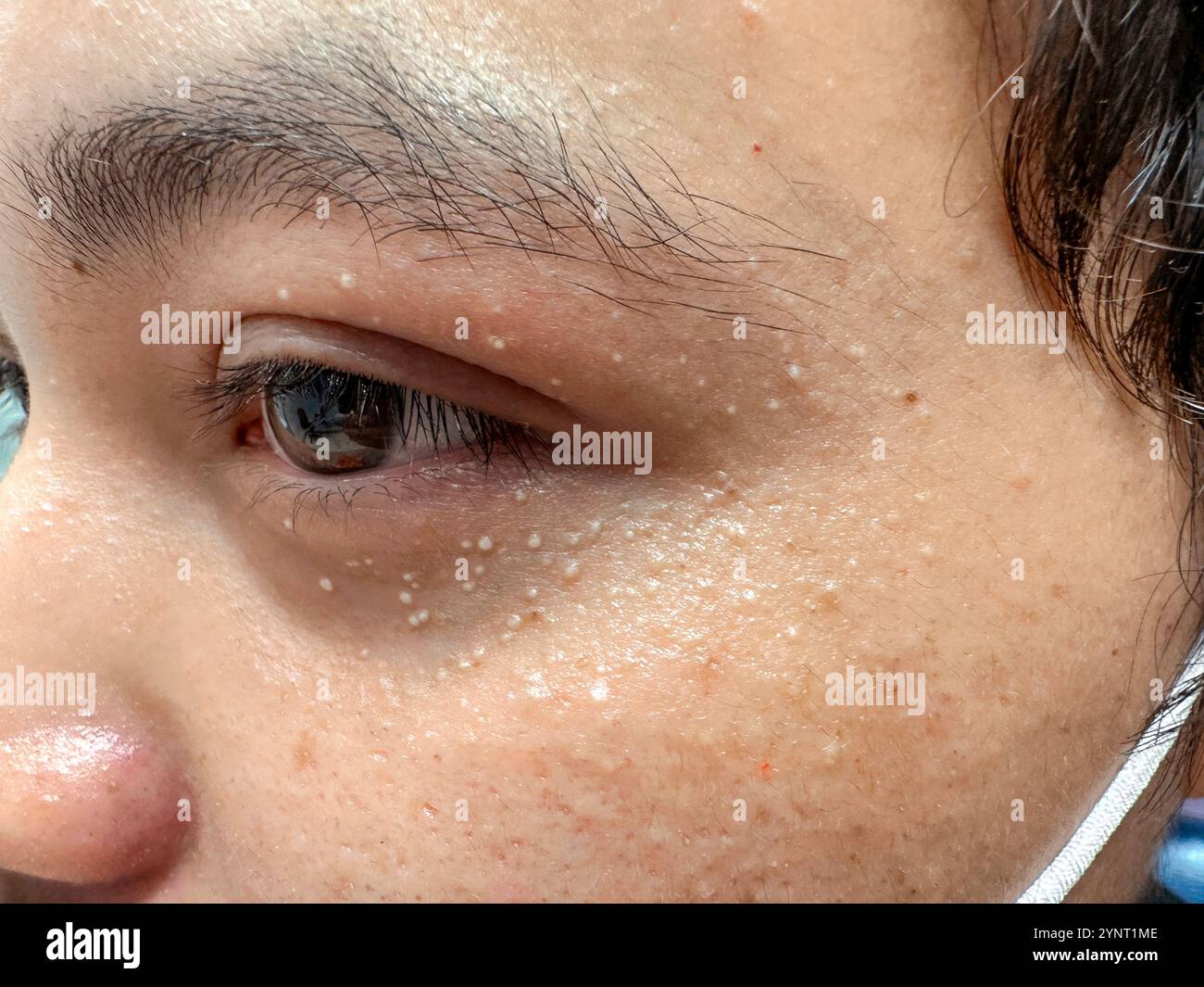 Not to be used for advertising or in a defamatory context Milia around ...