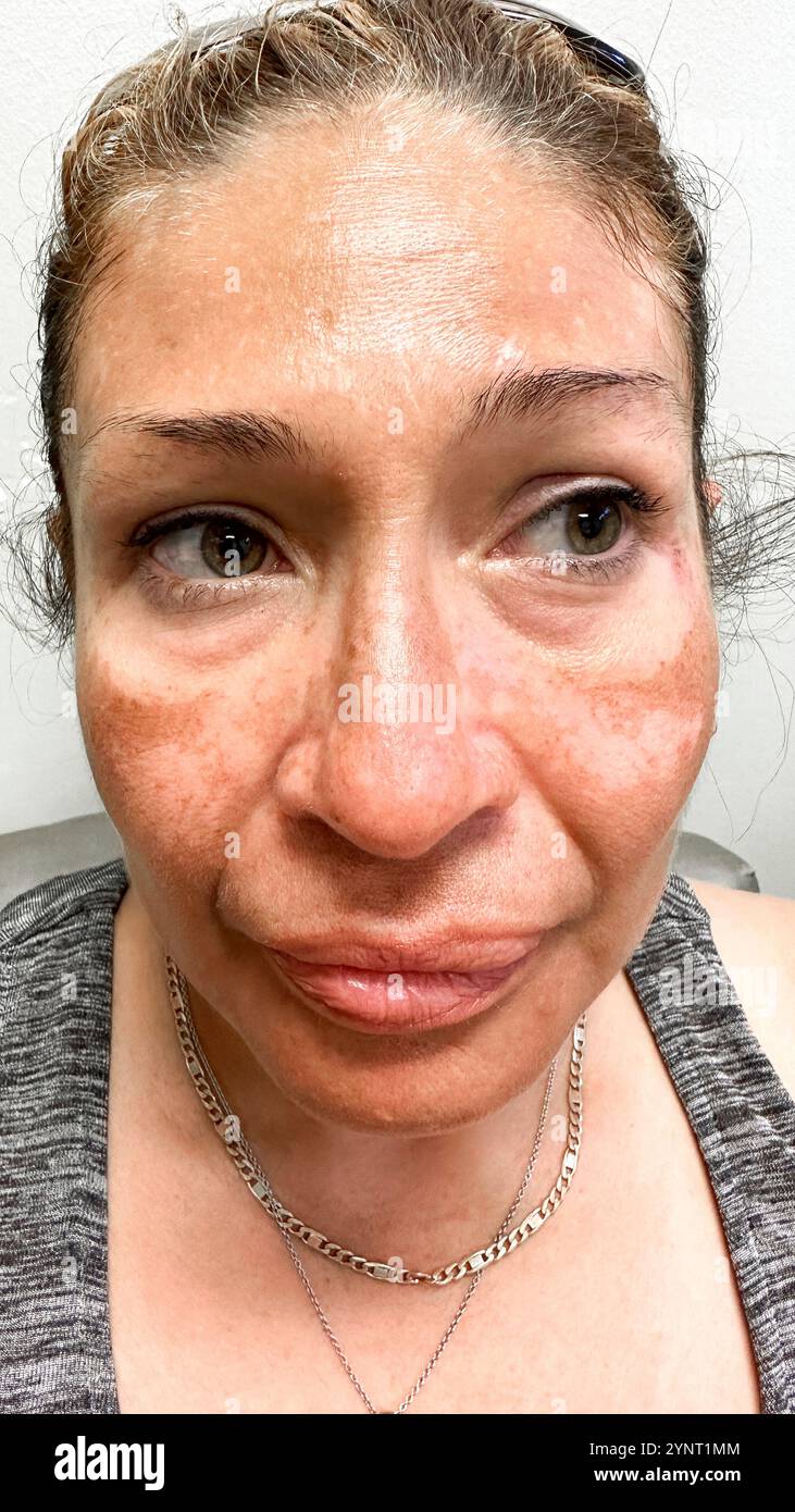 Editorial use only Melasma on a woman's face. Melasma, or chloasma, is ...