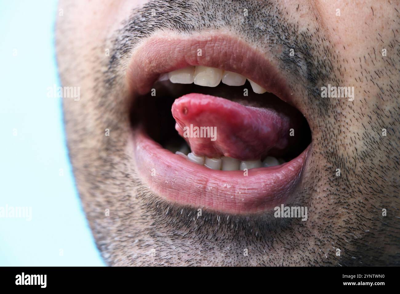 An asian man have aphthous ulcers on tongue Stock Photo - Alamy