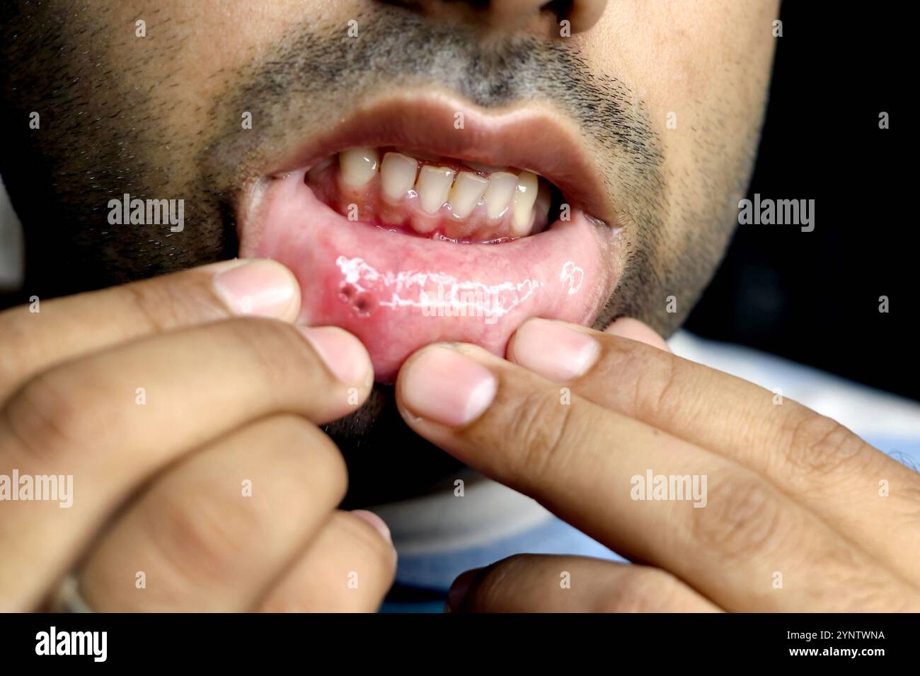 An asian man have aphthous ulcers on mouth Stock Photo - Alamy
