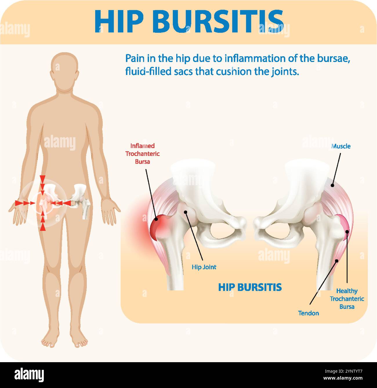 Illustration of hip bursitis and affected areas Stock Vector Image & Art - Alamy