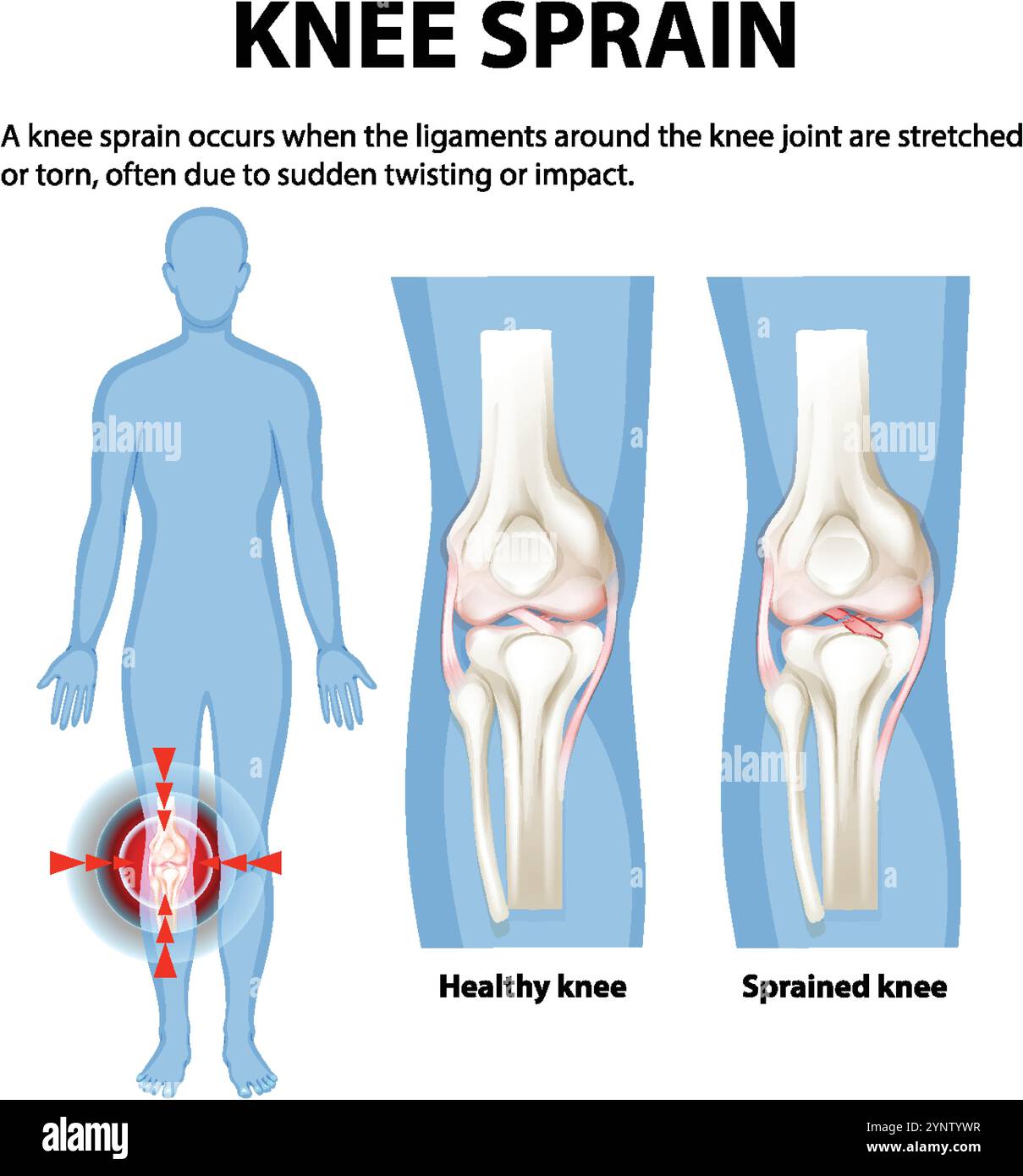 Illustration of healthy and sprained knee anatomy Stock Vector Image ...