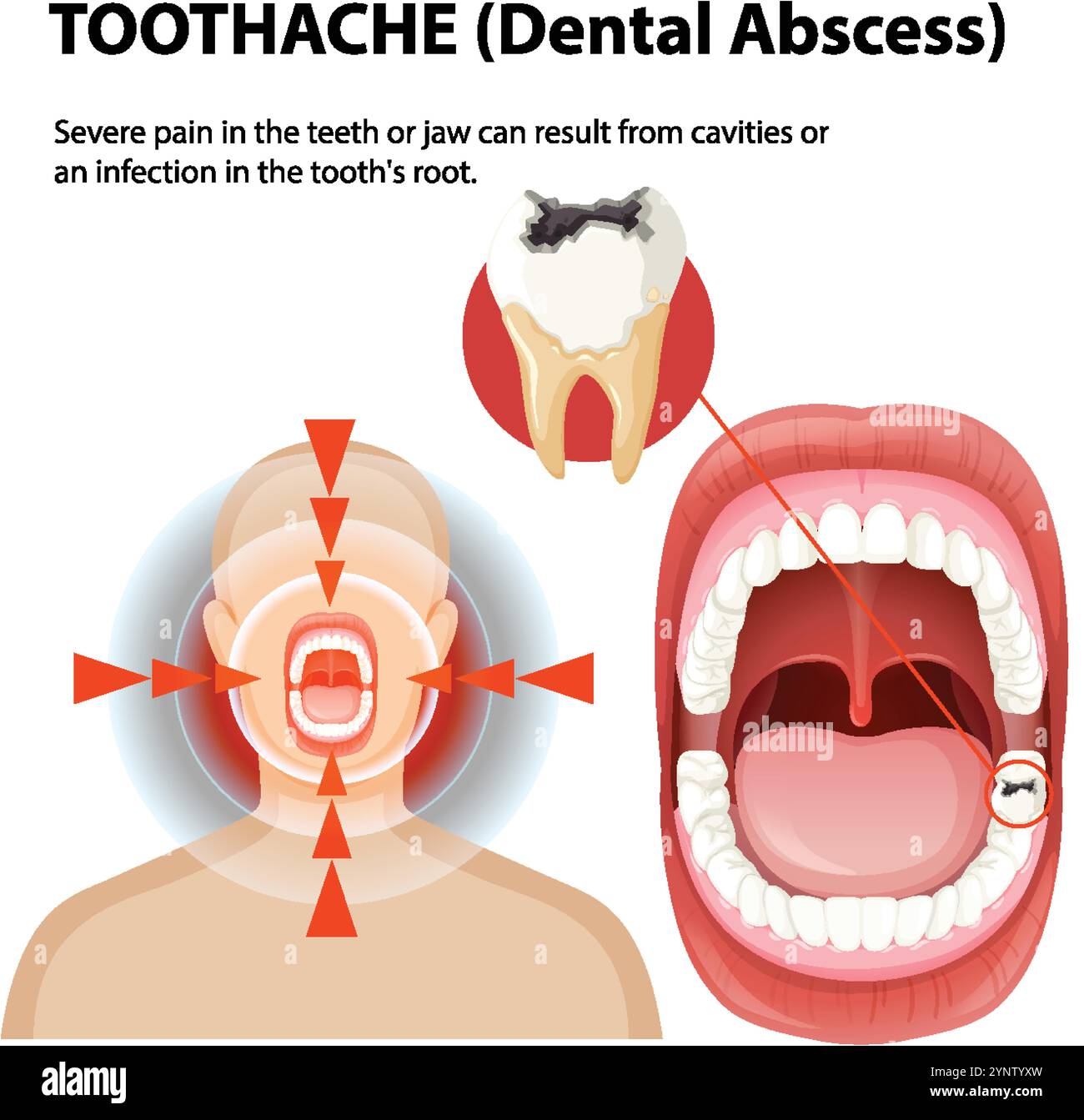 Illustration of toothache causes and symptoms Stock Vector Image & Art ...