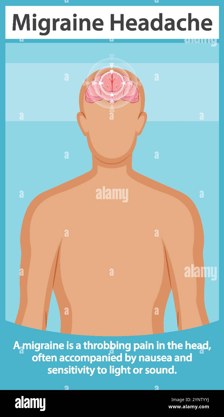 Illustration of migraine symptoms and affected areas Stock Vector Image ...