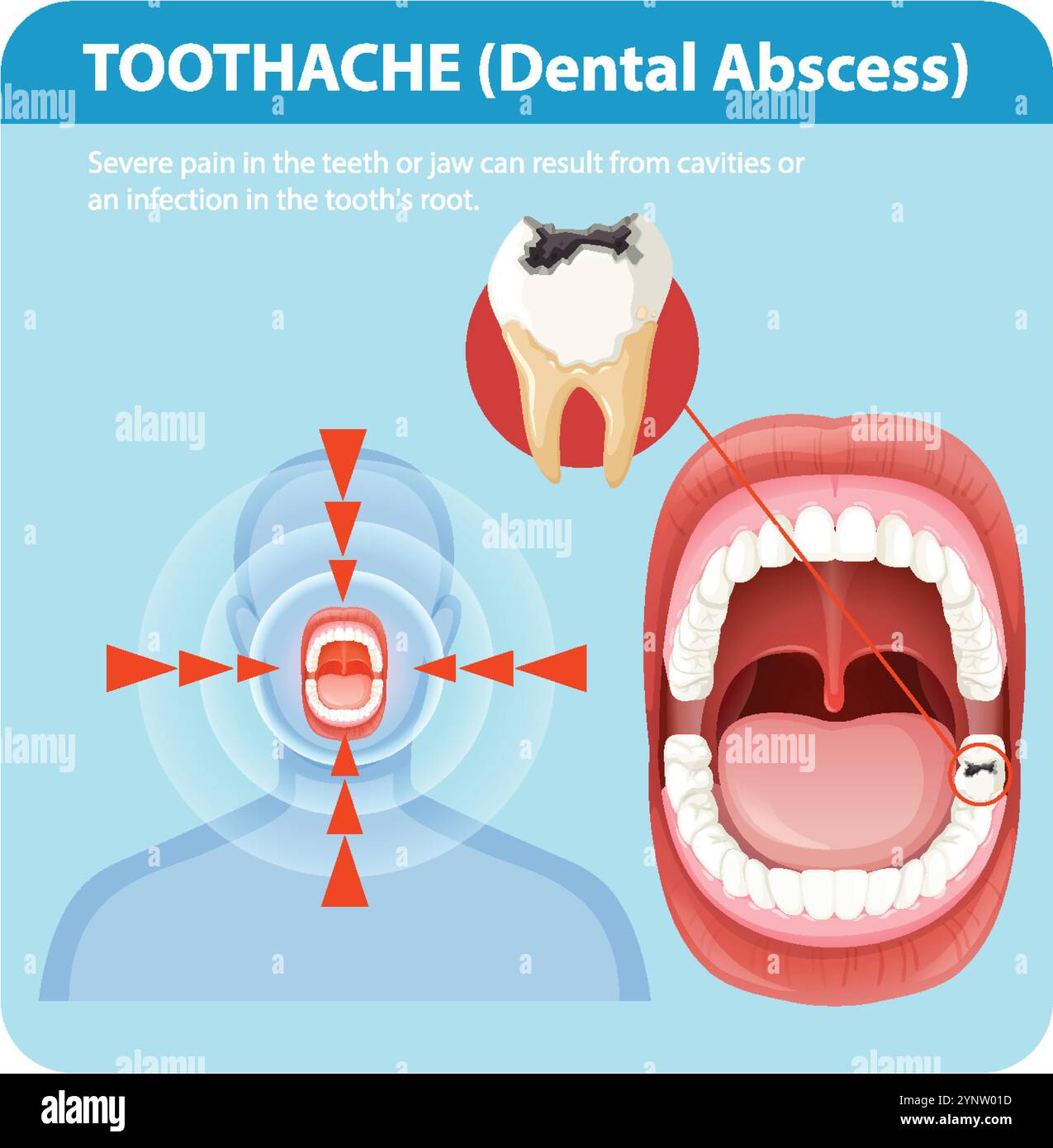 Illustration of tooth pain and dental abscess Stock Vector Image & Art ...