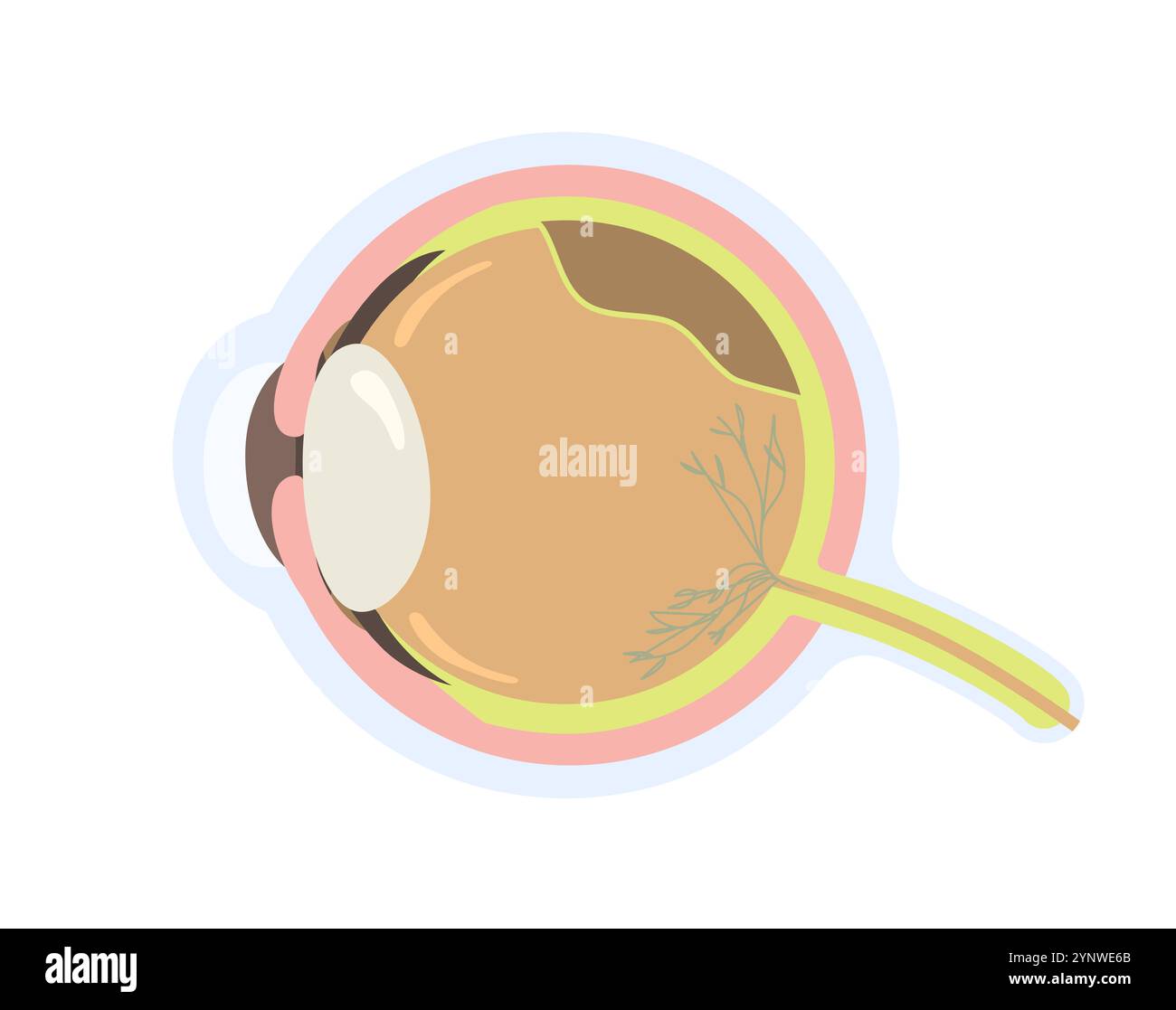 Eye with retinal detachment vector illustration. Detached retina after ...