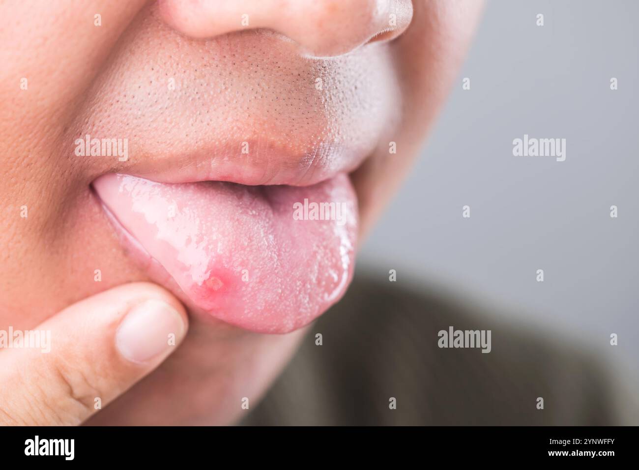 Sore Tongue And Mouth Symptoms