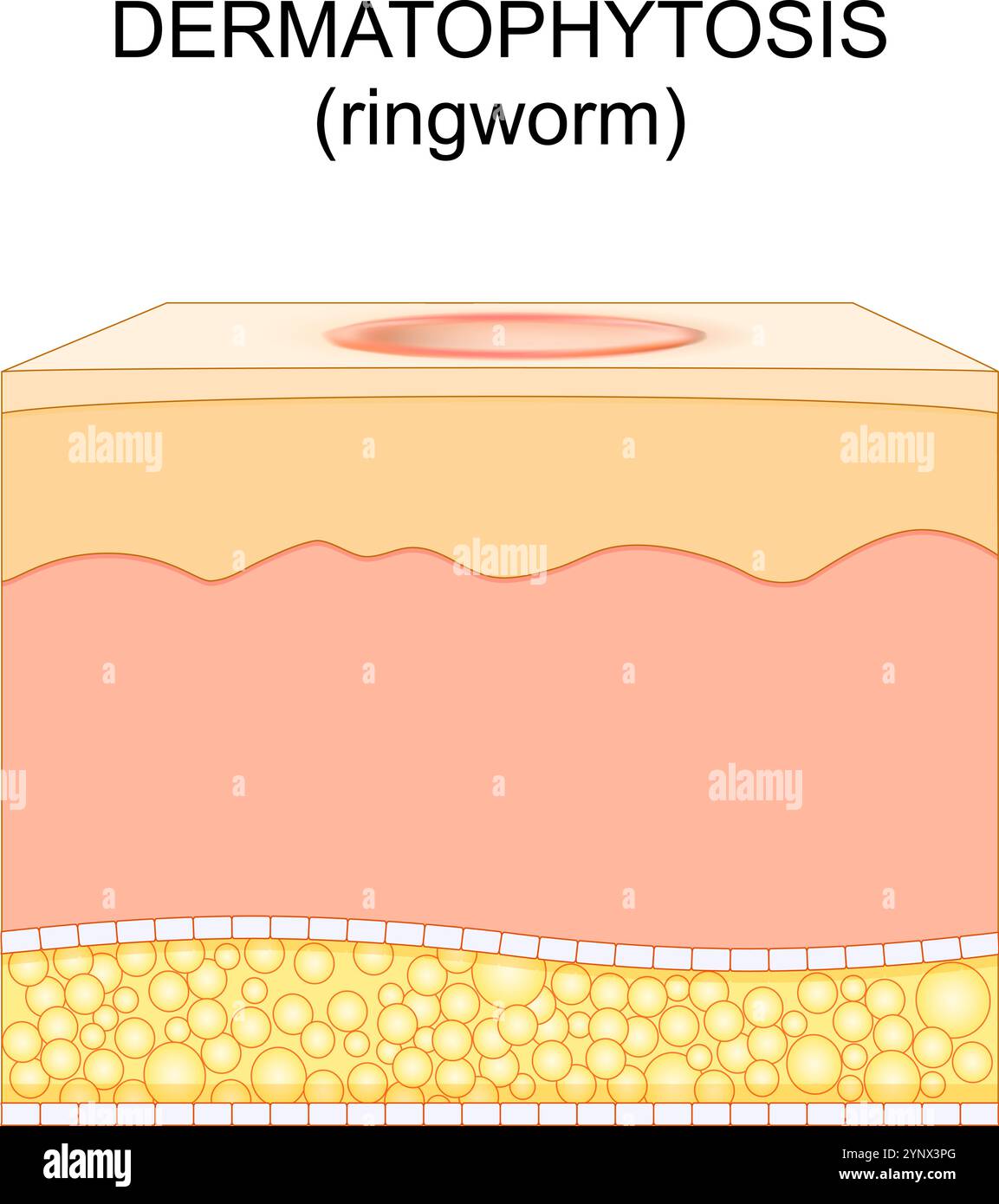 Dermatophytosis. fungal skin infection. Cross section of a human skin ...