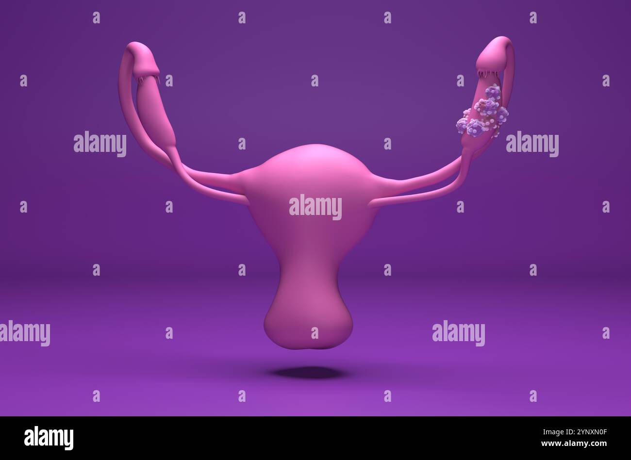 Ovarian cancer - isometric view 3d illustration Stock Photo - Alamy