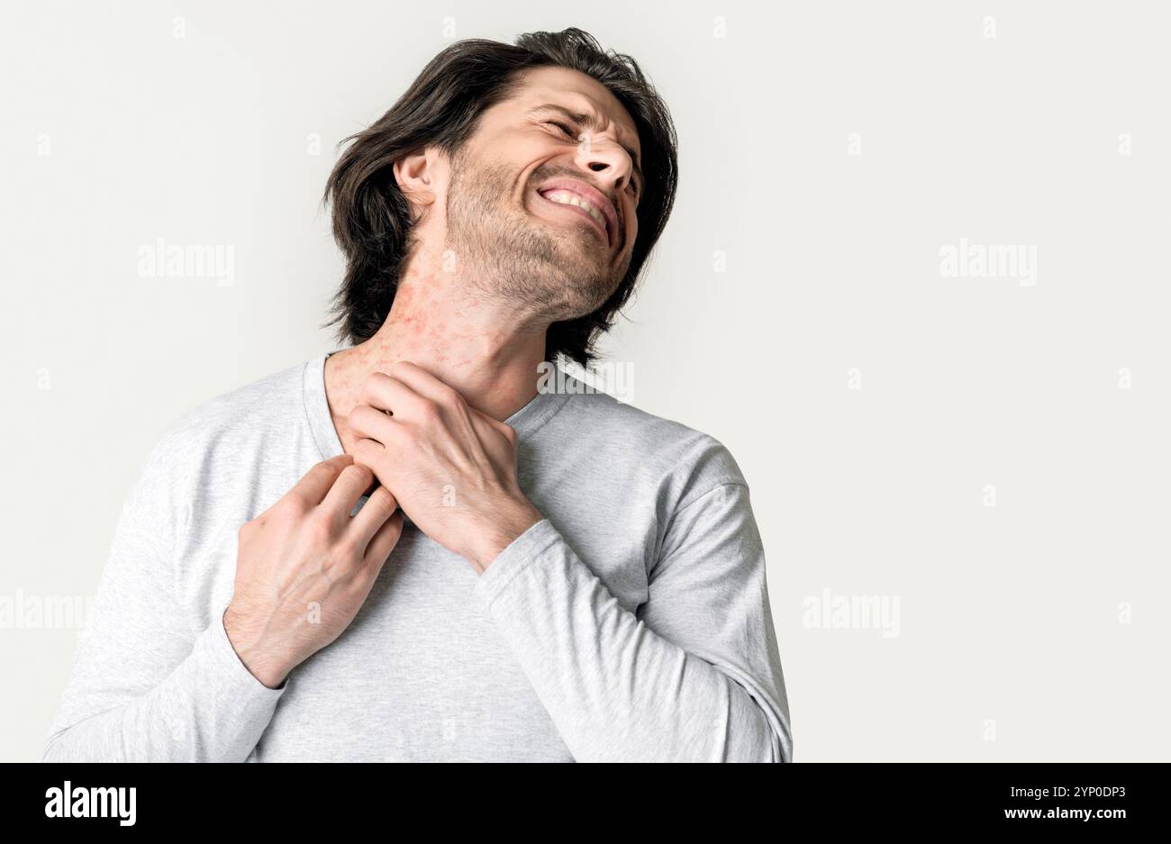 Eczema concept. Man suffers from skin irritation Stock Photo - Alamy