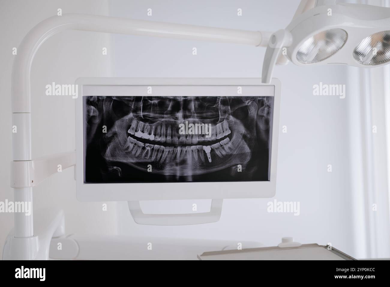 Dental Xray image displayed on a monitor in a modern clinic ...