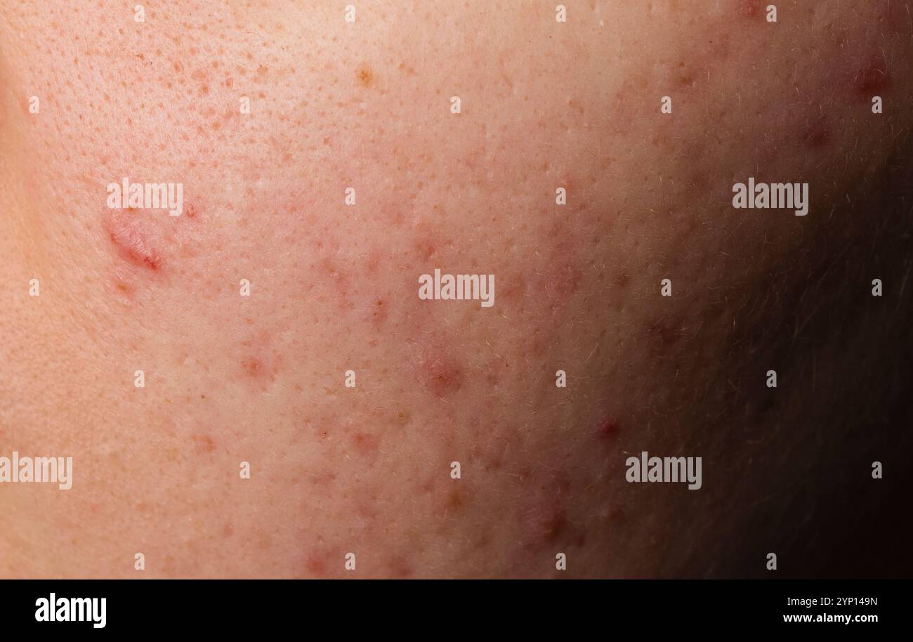 Skincare. Acne treatment. Face, skin, pimples. Girl with pimples ...