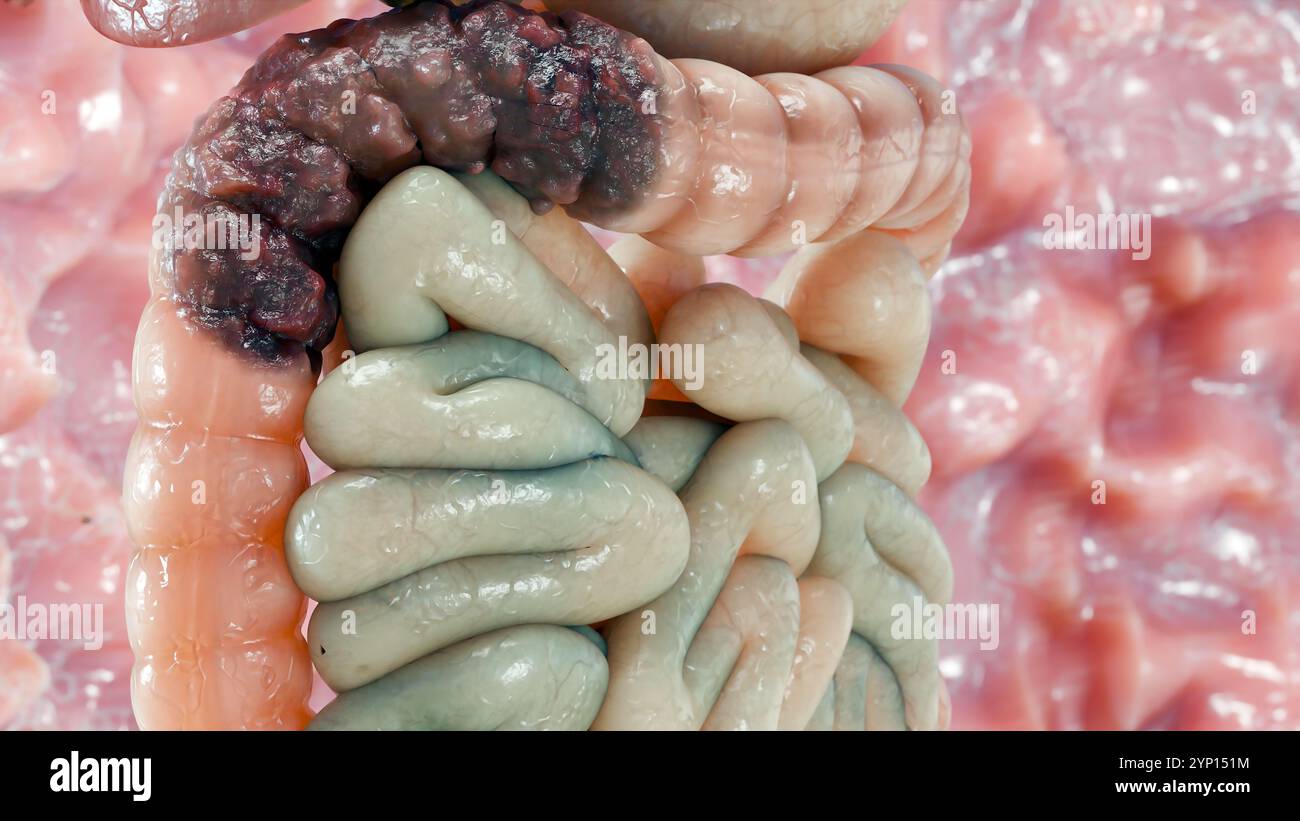 Colorectal cancer, malignant tumor in intestine, Endoscope inside ...