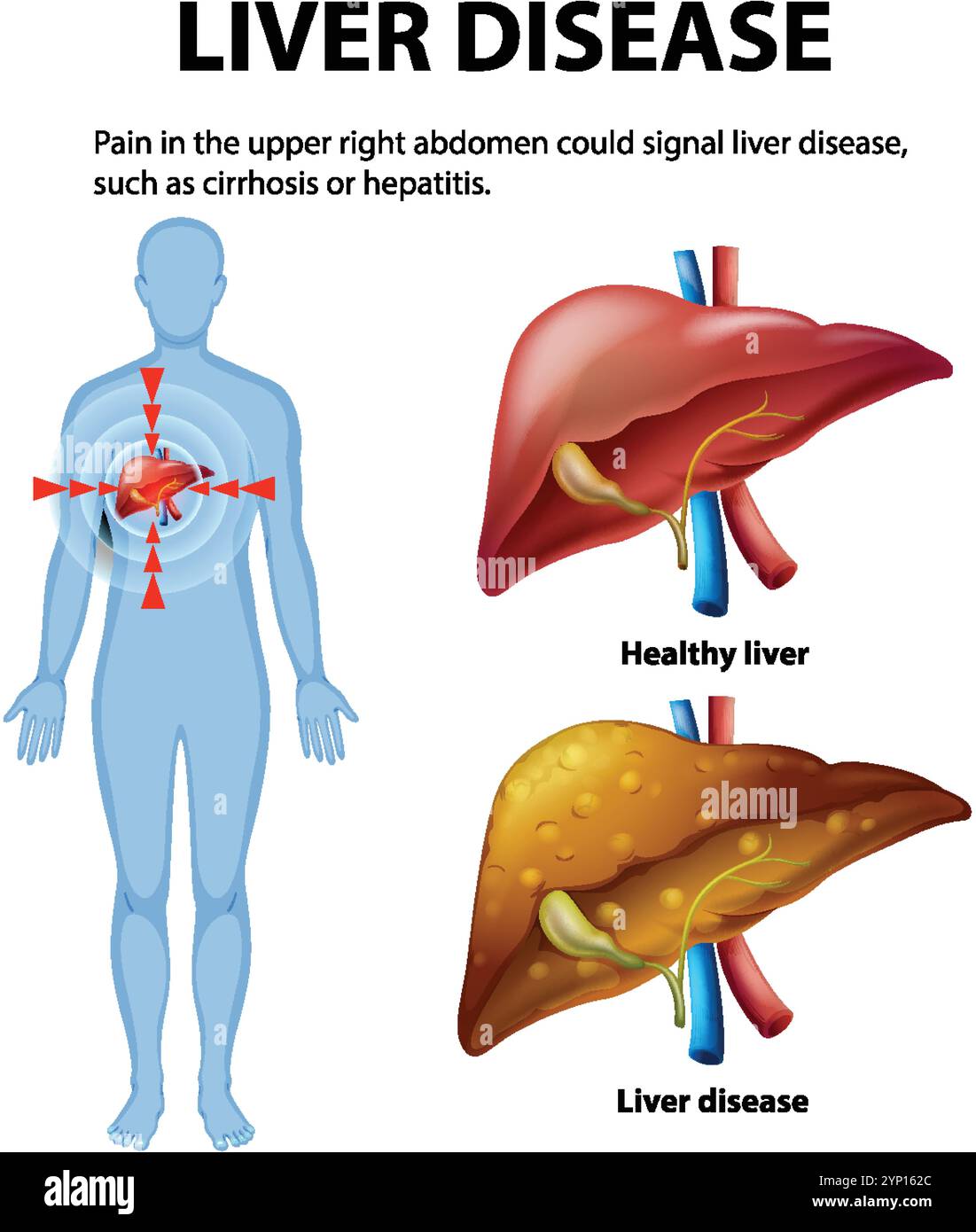 Illustration of healthy and diseased liver comparison Stock Vector ...