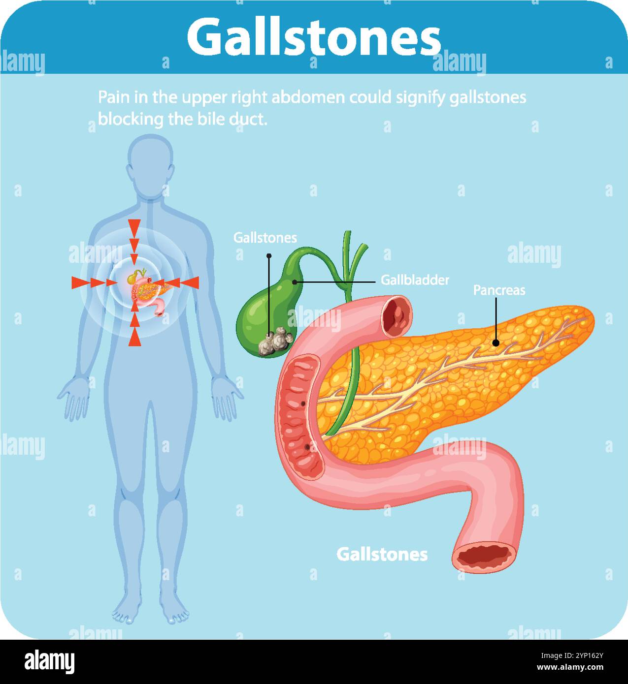 Illustration of gallstones affecting the human body Stock Vector Image ...