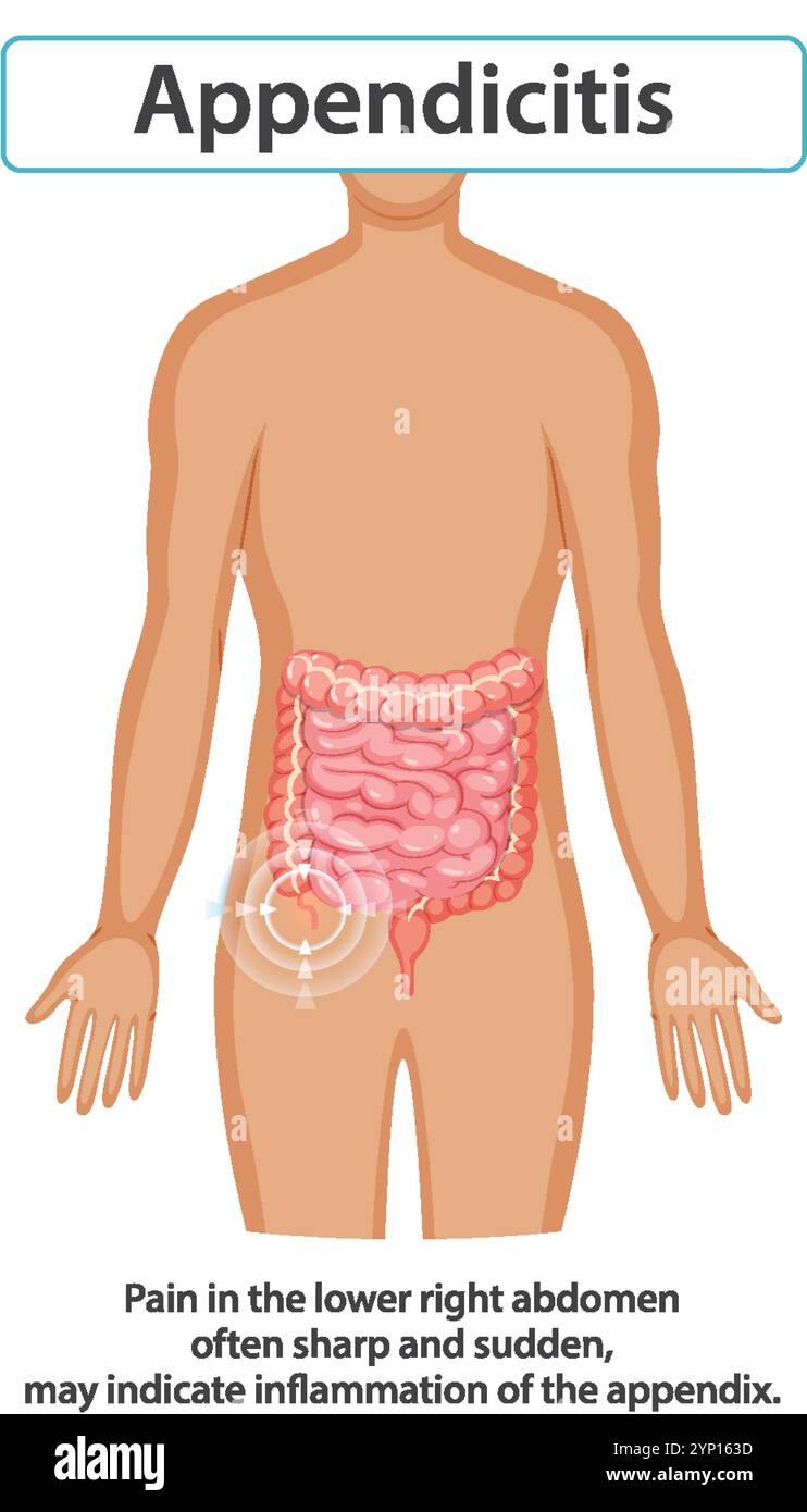 Diagram showing appendicitis location and symptoms Stock Vector Image & Art - Alamy