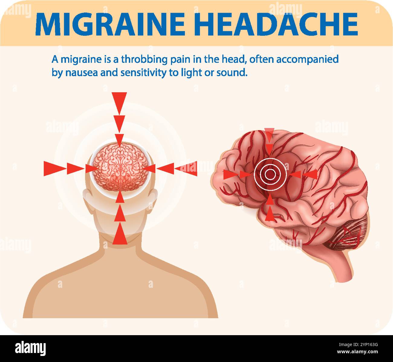 Illustration of migraine pain and brain anatomy Stock Vector Image ...
