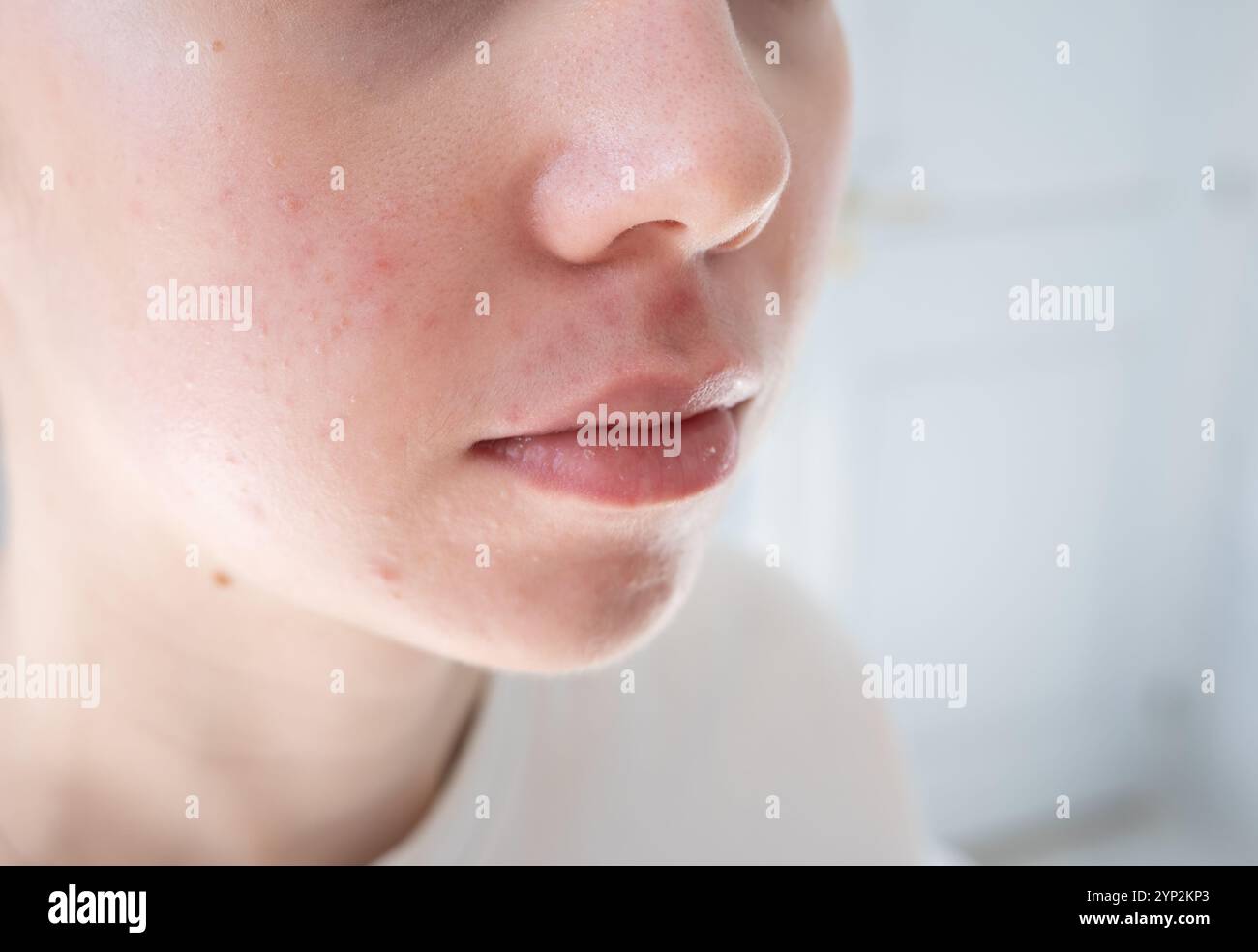 Close up of young woman with acne and post-acne marks on her cheeks ...
