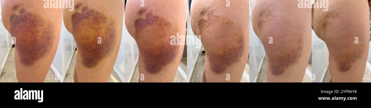 Stages of Bruise Healing on Human Skin Over Time Stock Photo - Alamy