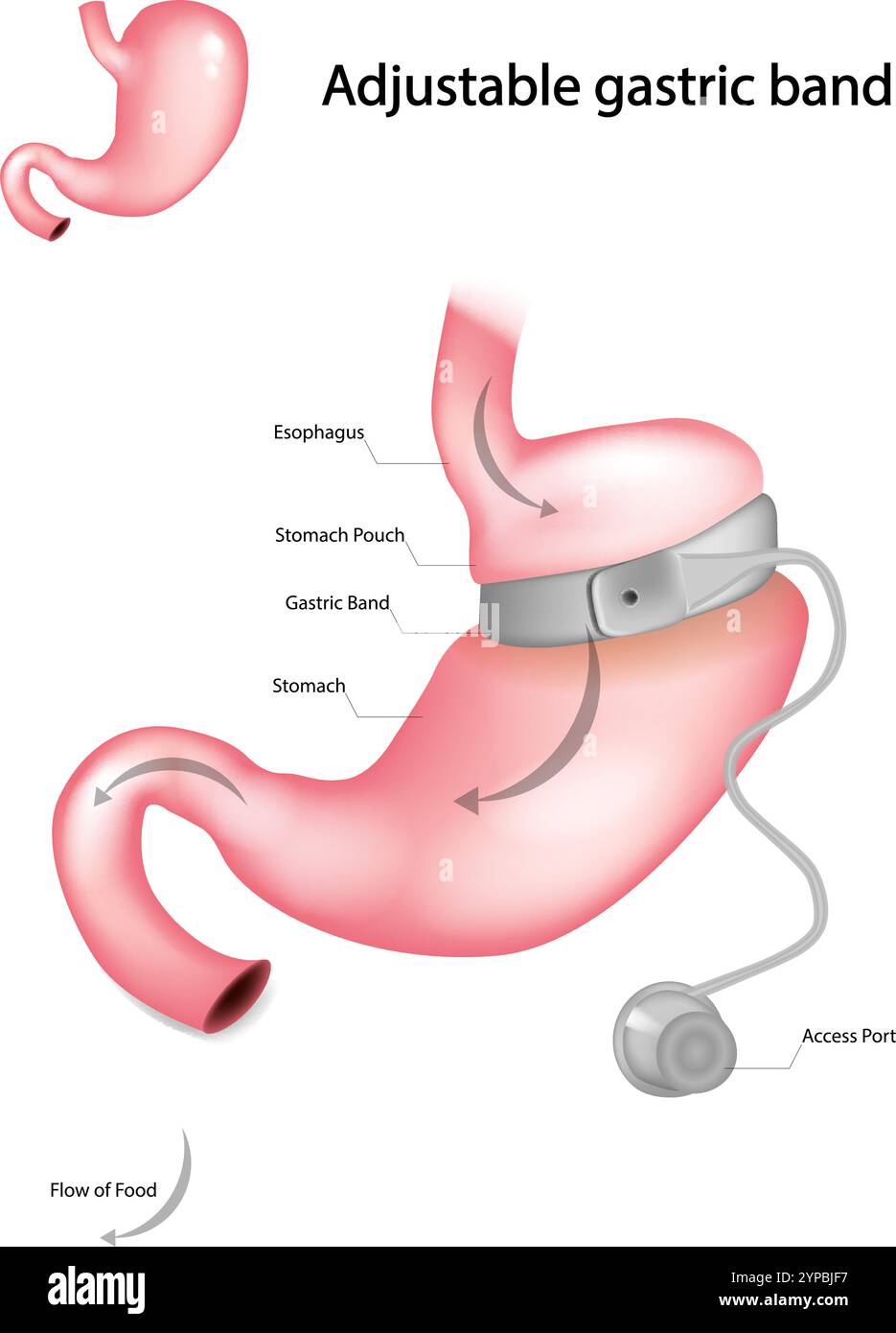 Laparoscopic adjustable banding hi-res stock photography and images - Alamy