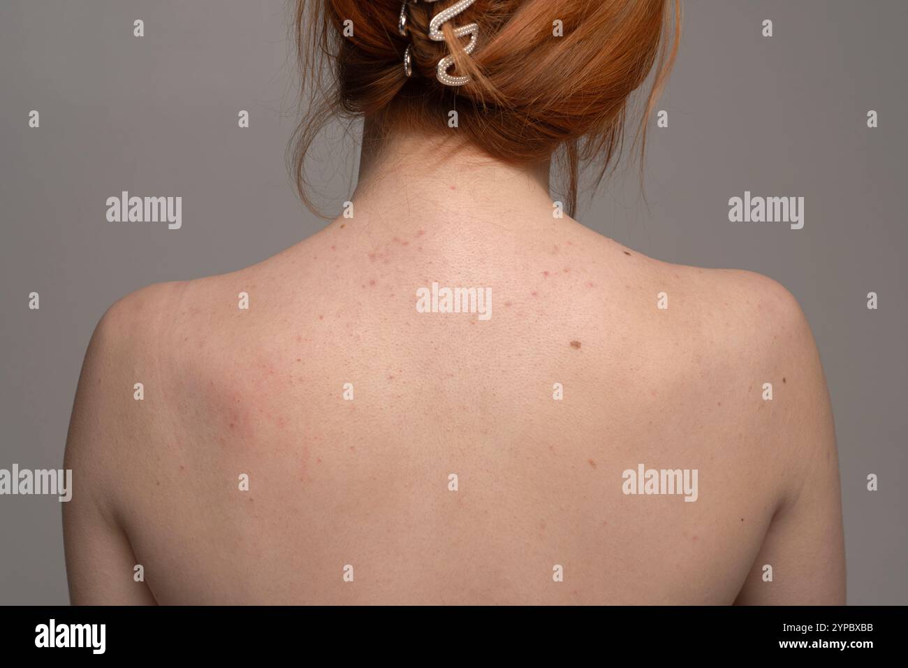 Pimple on back. Skin acne background. Pimples on back. Acne problem on ...